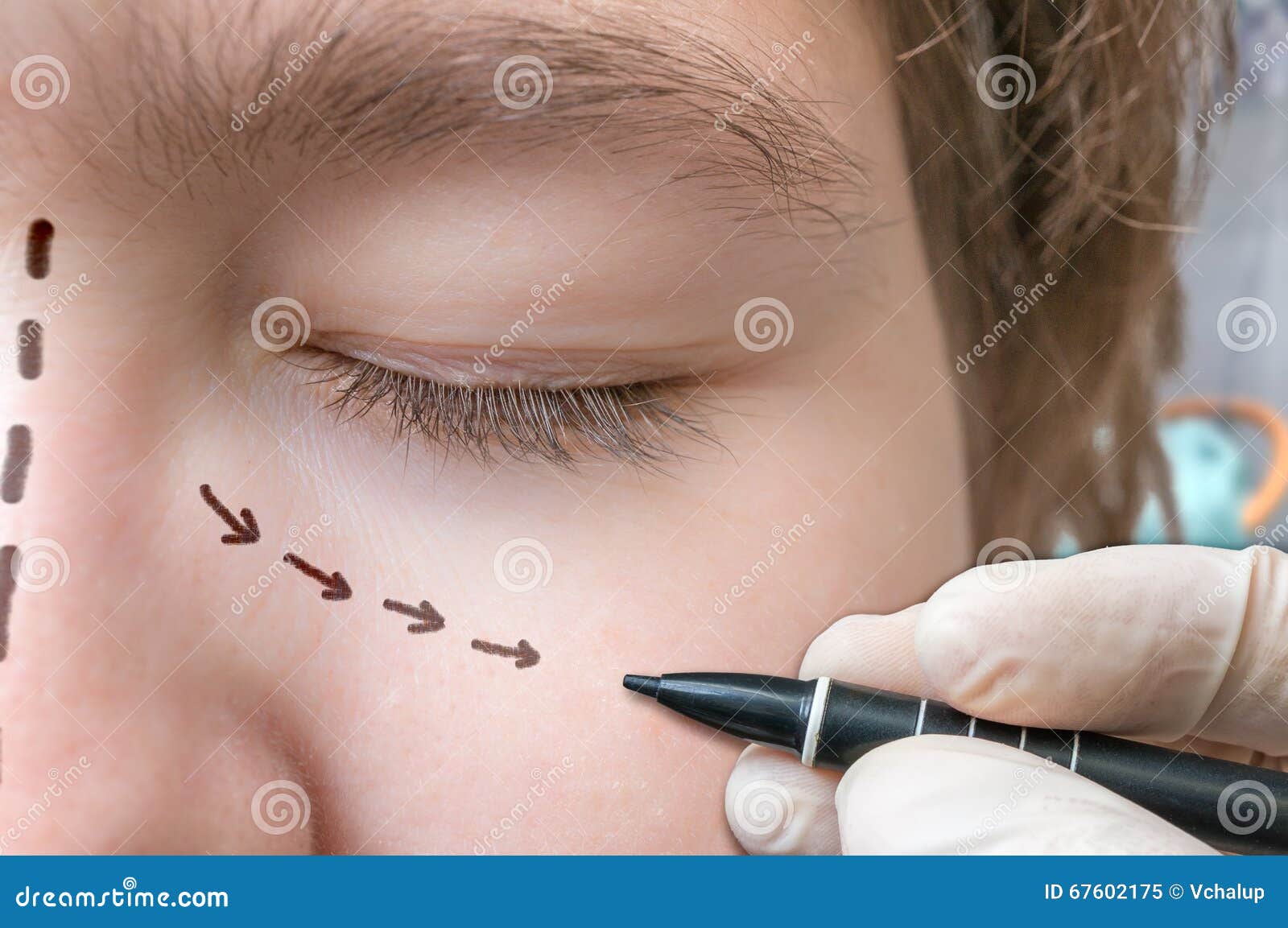 Facial Plastic Surgery. Hand is Drawing Lines with Marker Around Eye ...