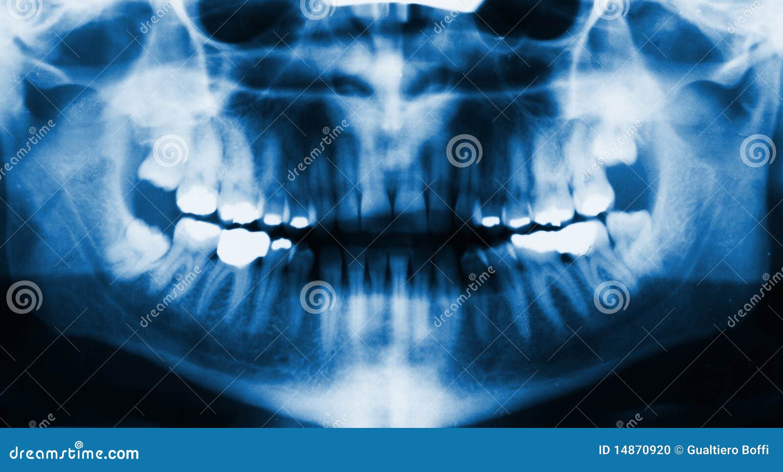 Facial x-ray stock photo. Image of disease, hospital - 14870920