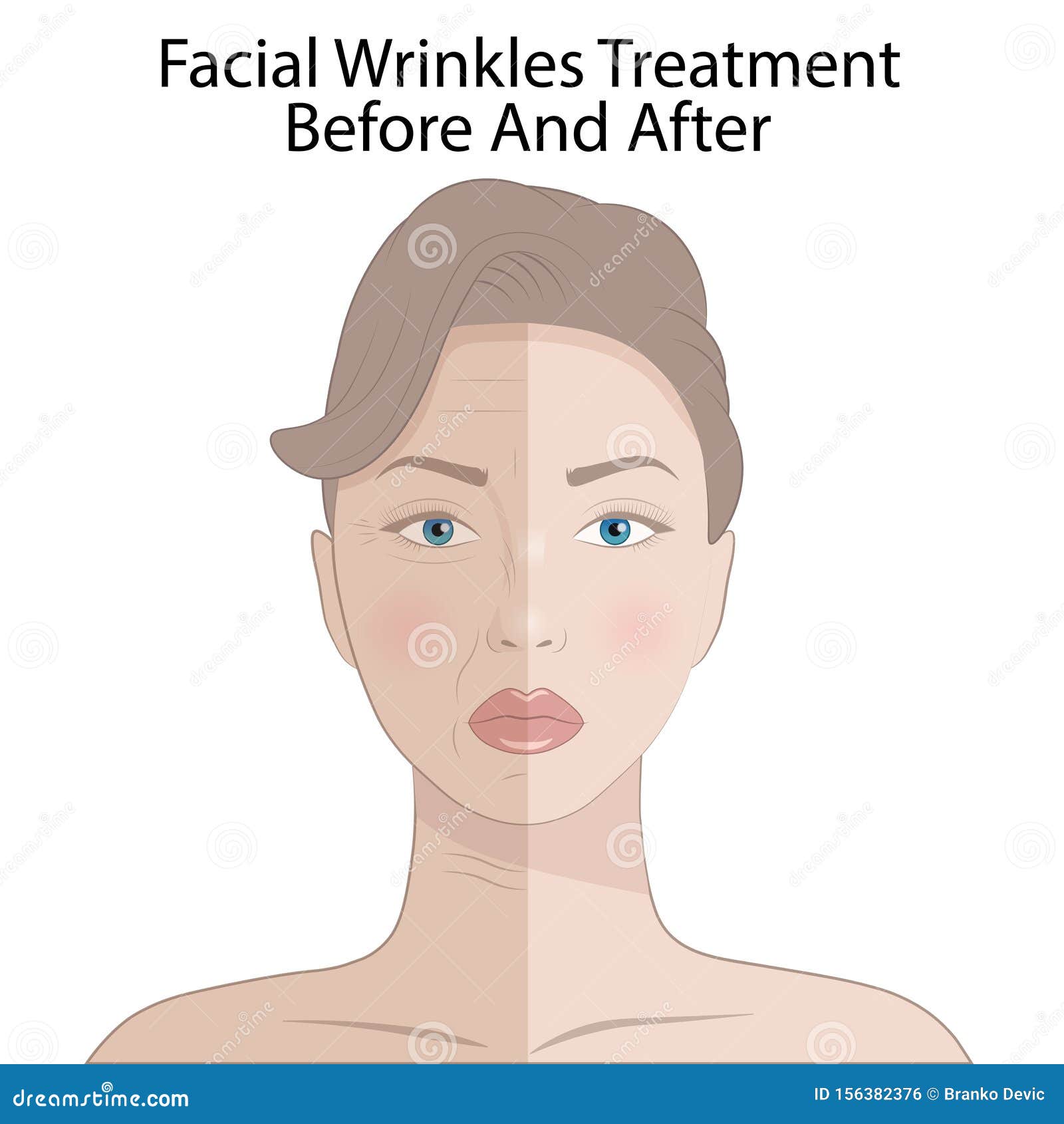 Vector Illustration of Common Types of Facial Wrinkles, Cosmetic ...