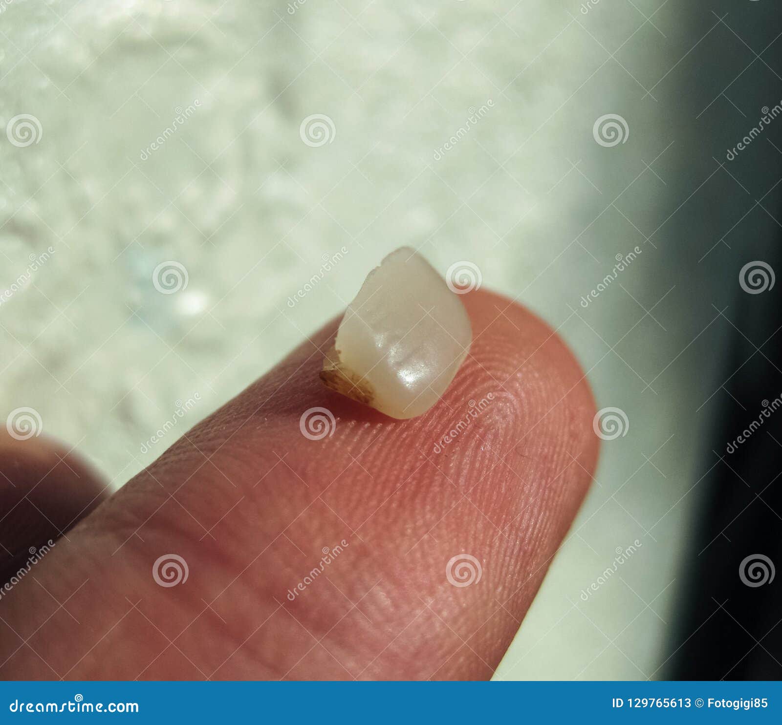 Fallen Off Old Filling with a Cutter. the Seal of the Tooth. Stock ...