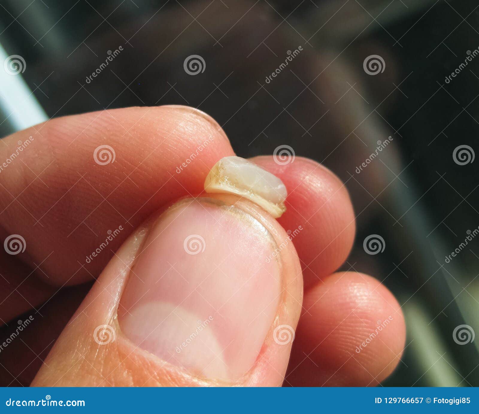 Fallen Off Old Filling with a Cutter. the Seal of the Tooth. Stock ...