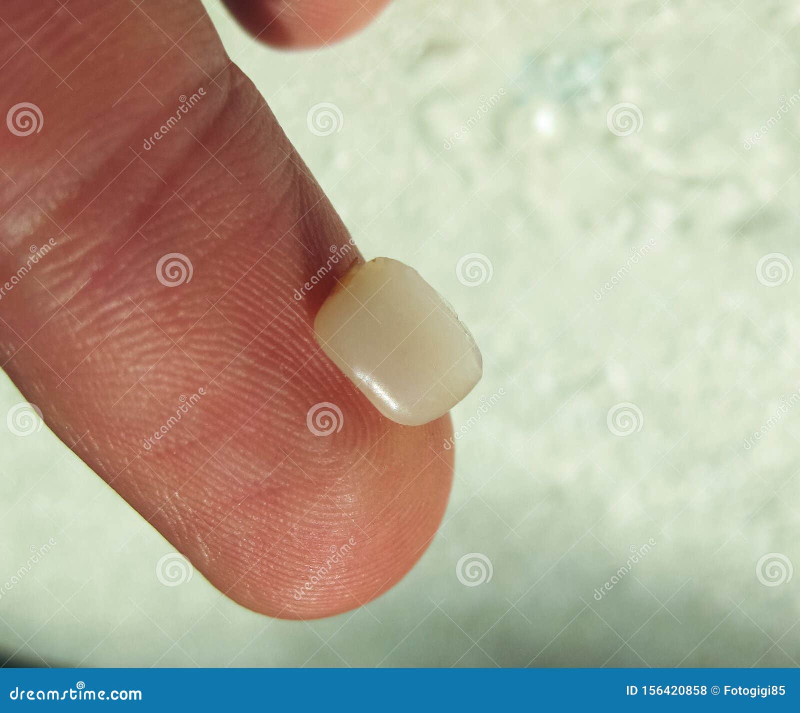 Fallen Off Old Filling with a the Seal of the Tooth Stock Photo - Image ...