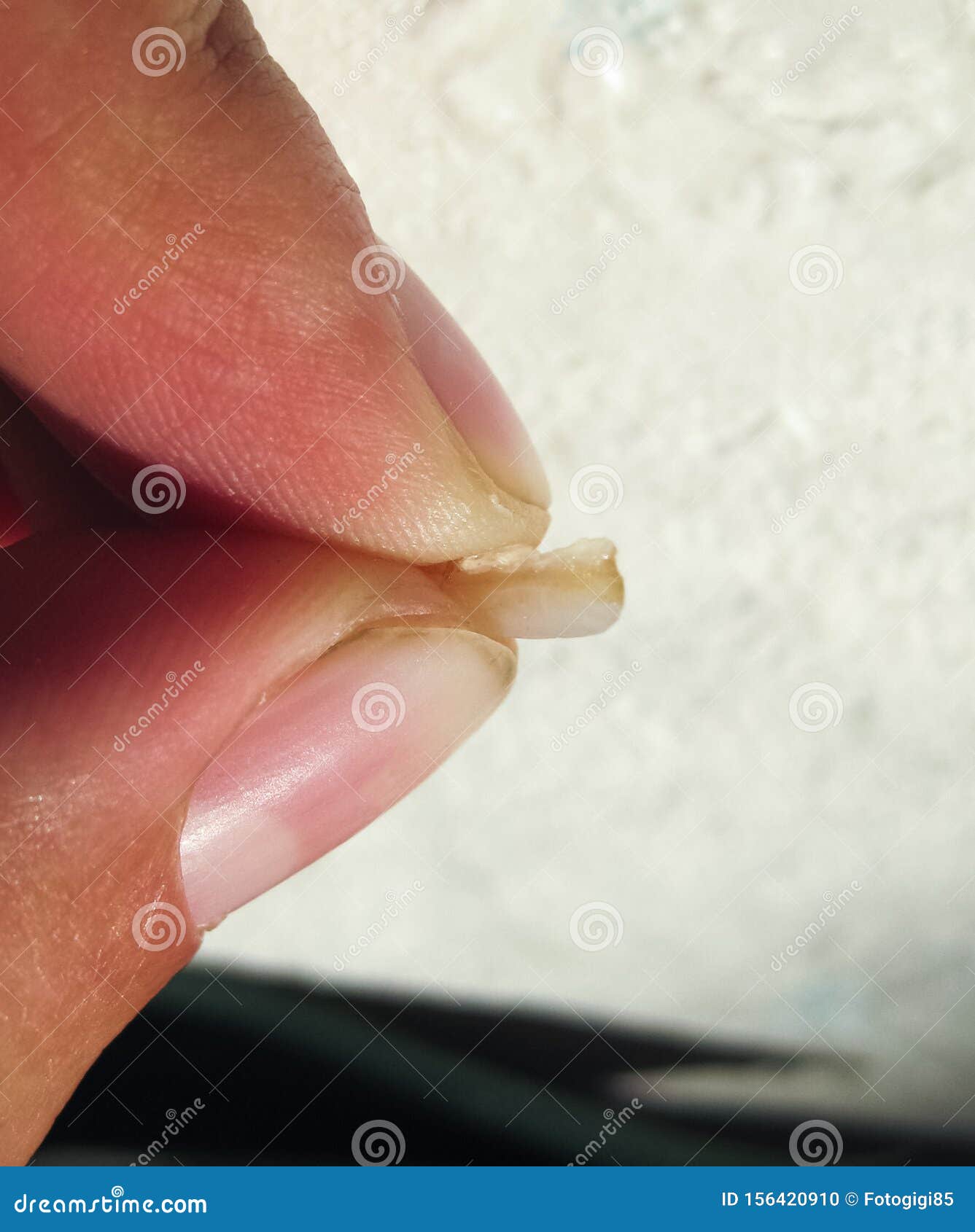 Fallen Off Old Filling with a . the Seal of the Tooth Stock Photo ...