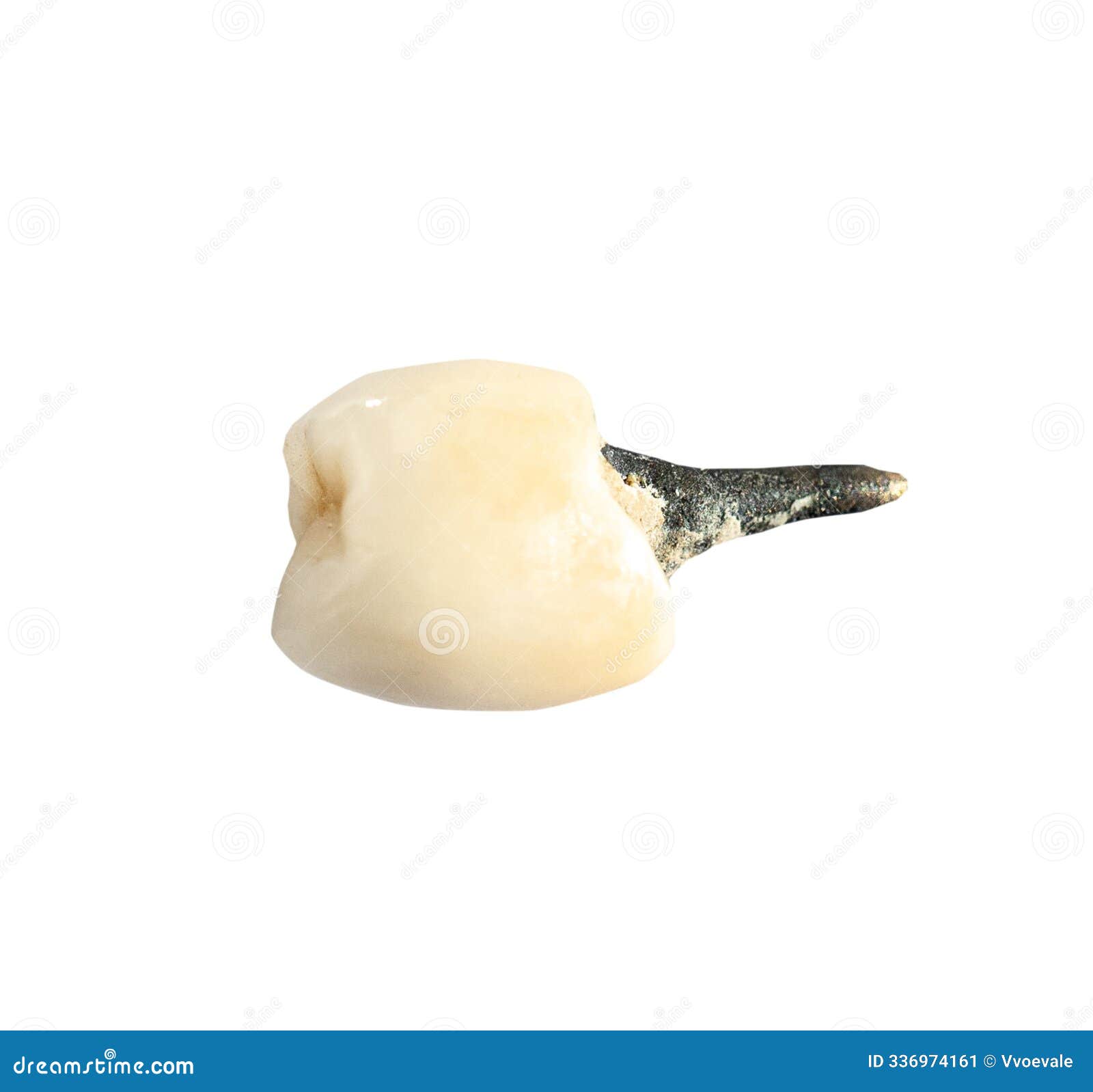 Fallen Out Implant with Ceramic Tooth Crown Stock Image - Image of ...