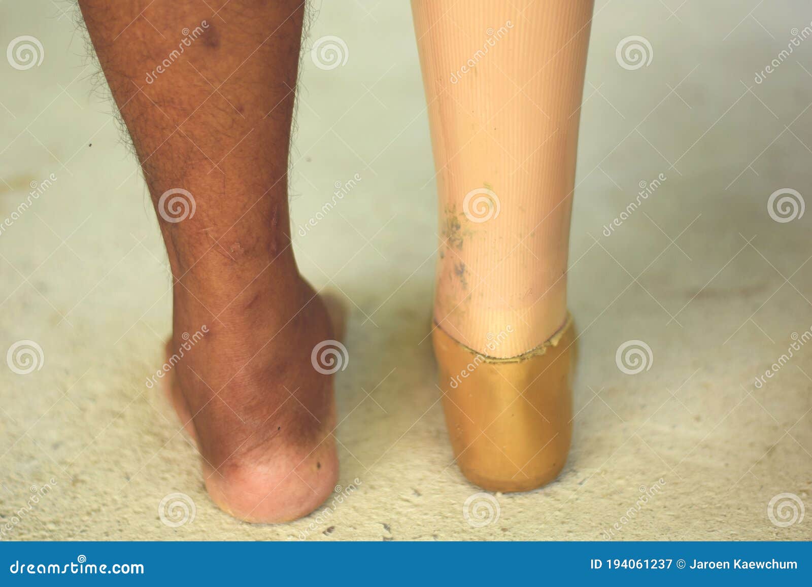False Legs for Amputated Persons Stock Image - Image of help, hand ...