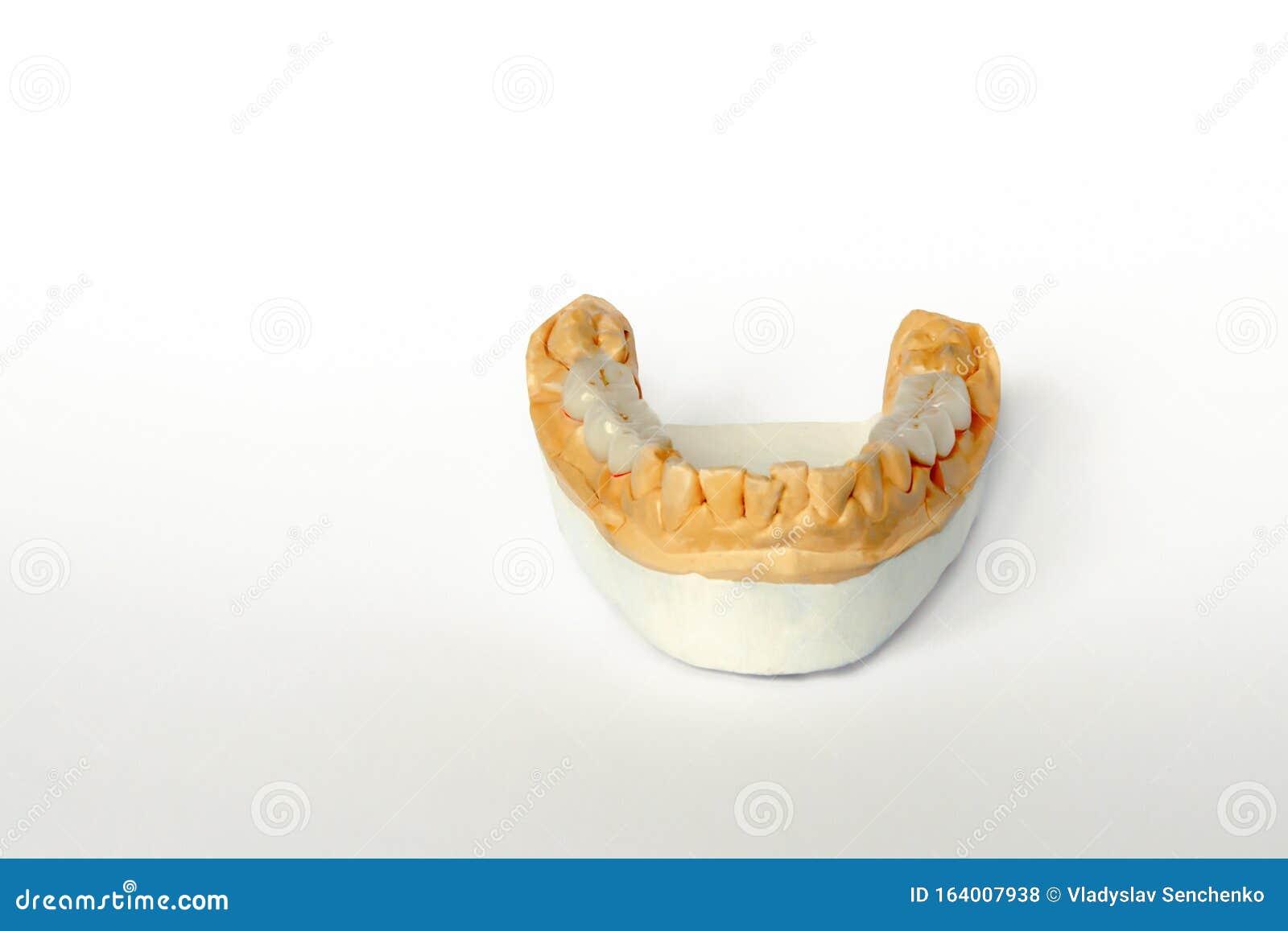 False Teeth. Bridge-ceramic-metal Prostheses Stock Photo - Image of ...