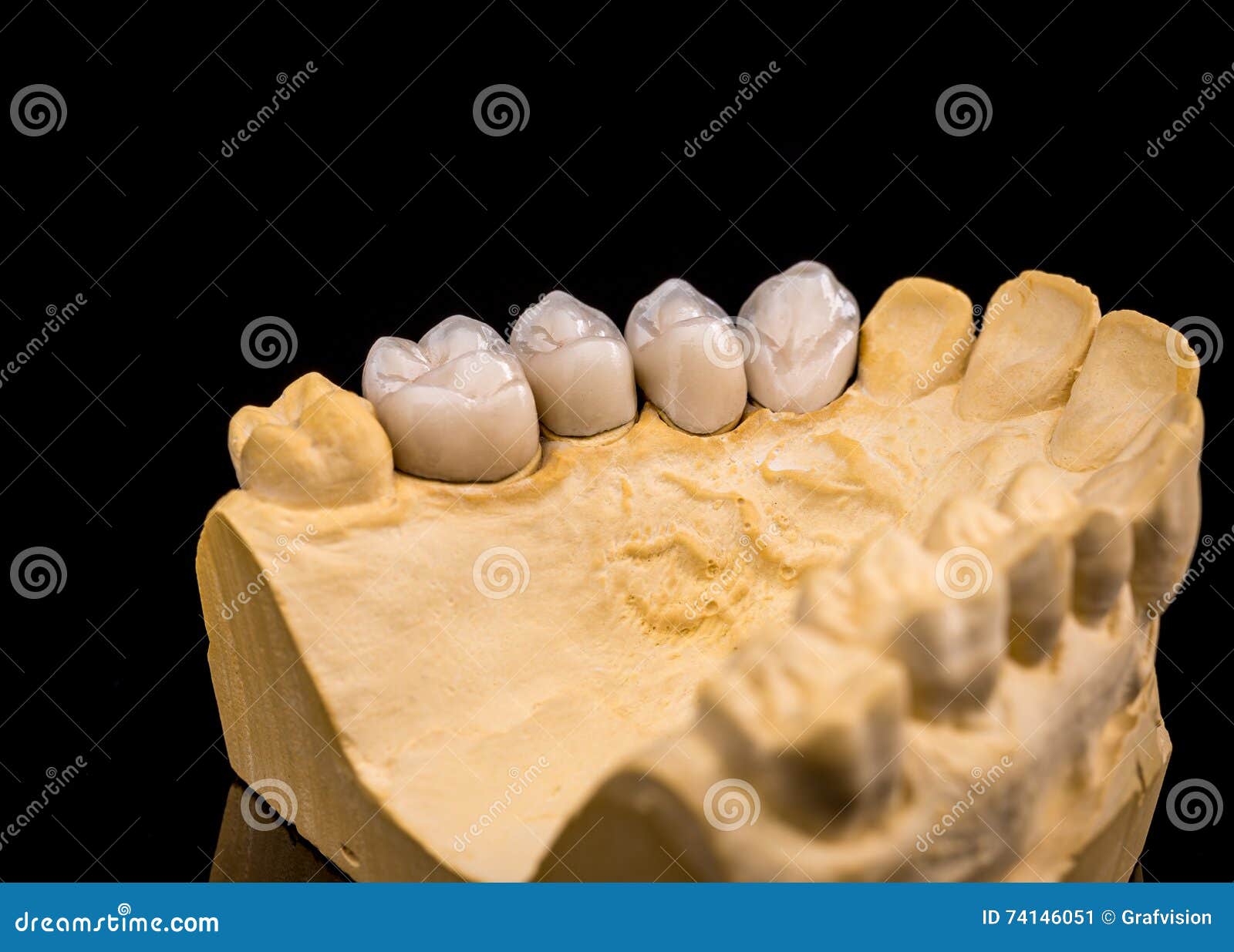 False teeth stock image. Image of ceramic, orthodontic - 74146051