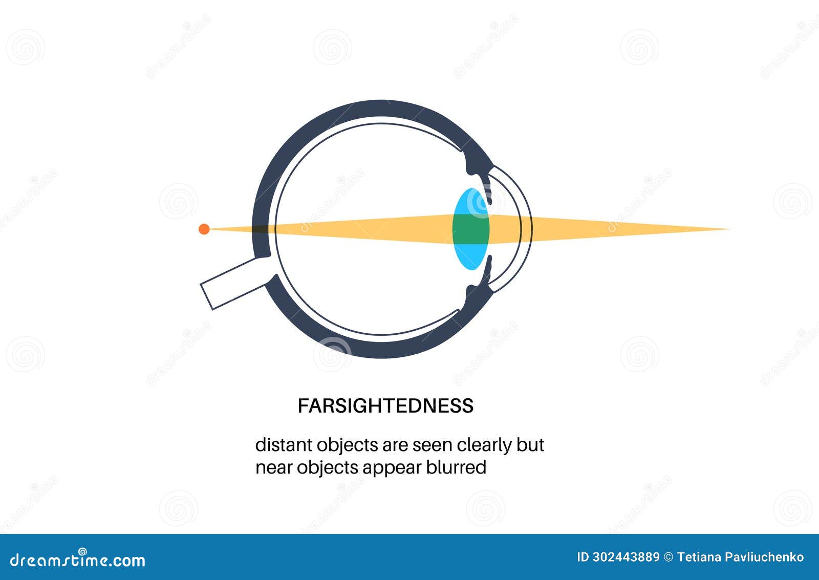 Farsightedness eye disease stock vector. Illustration of vision - 302443889