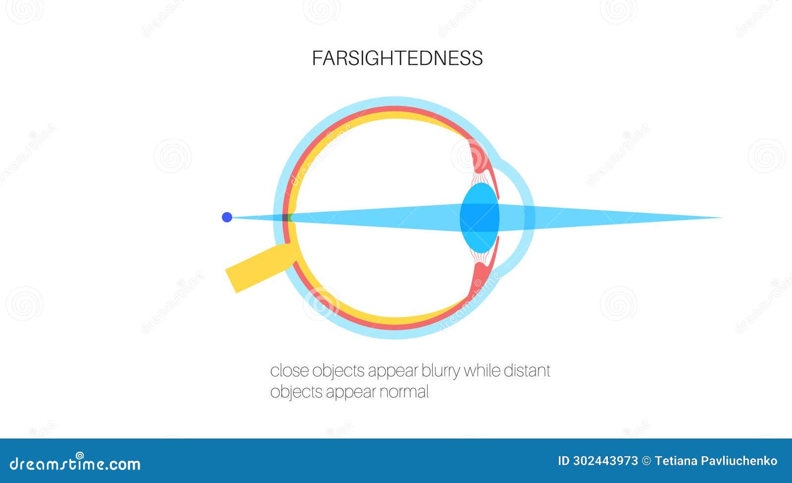 Farsightedness Lens Correction Vector Illustration | CartoonDealer.com ...