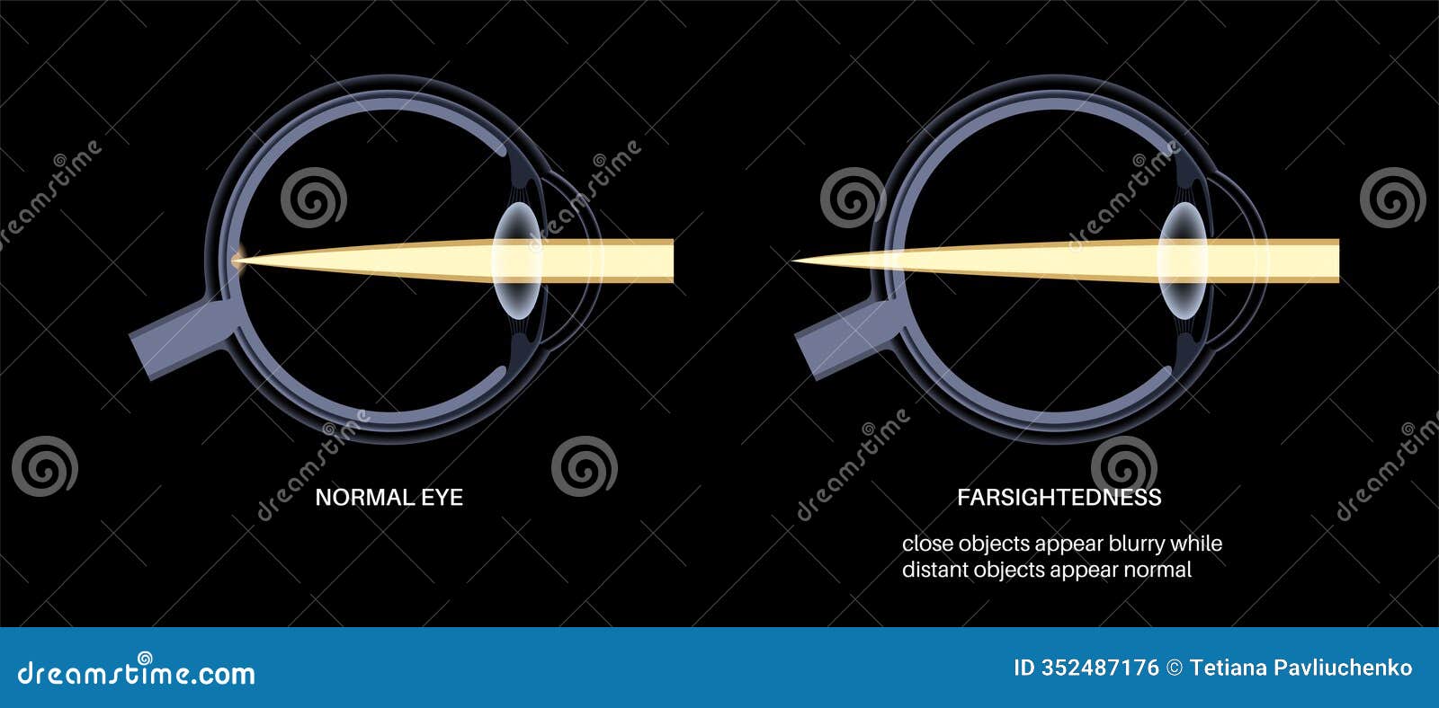 Farsightedness Structure Diagram Medical Science Vector Illustration ...