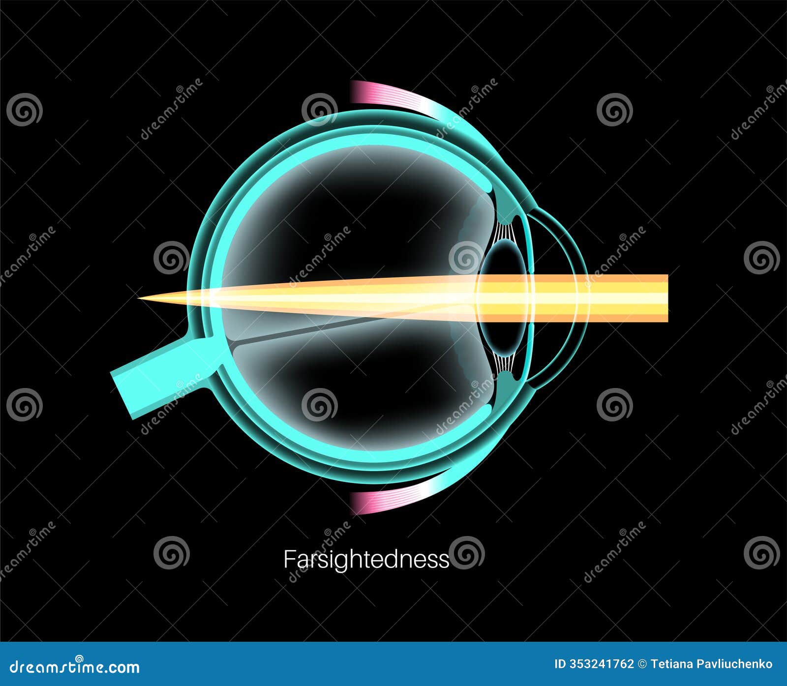 Farsightedness eye disease stock illustration. Illustration of ...