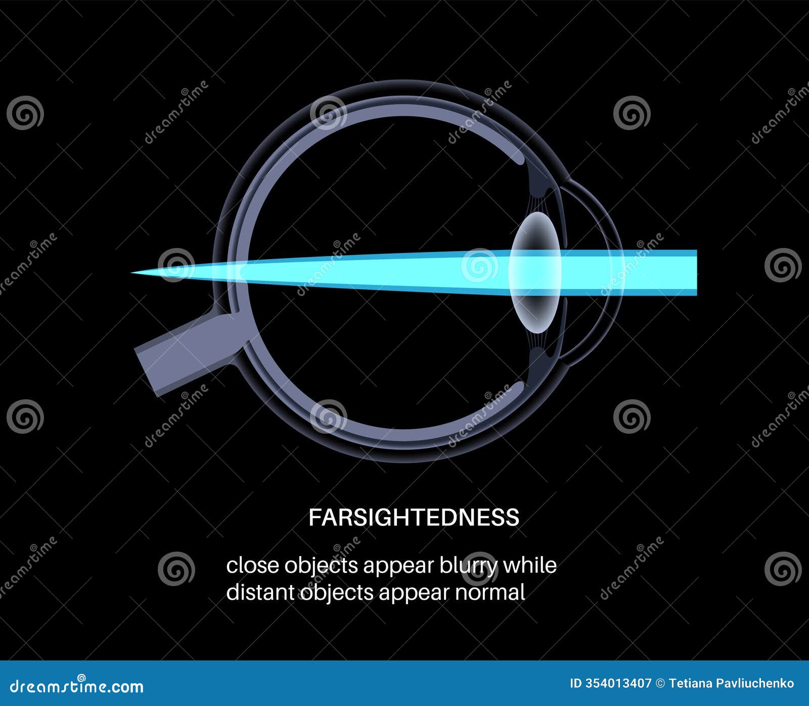 Farsightedness Structure Diagram Medical Science Vector Illustration ...