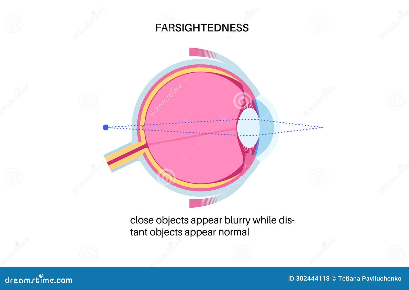 Farsightedness eye disease stock vector. Illustration of long - 302444118
