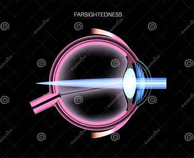 Farsightedness eye disease stock vector. Illustration of hyperopia ...