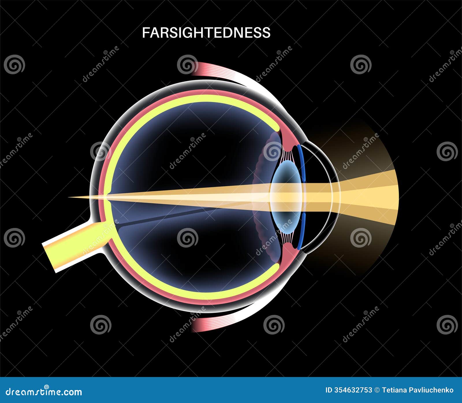 Farsightedness Structure Diagram Medical Science Vector Illustration ...