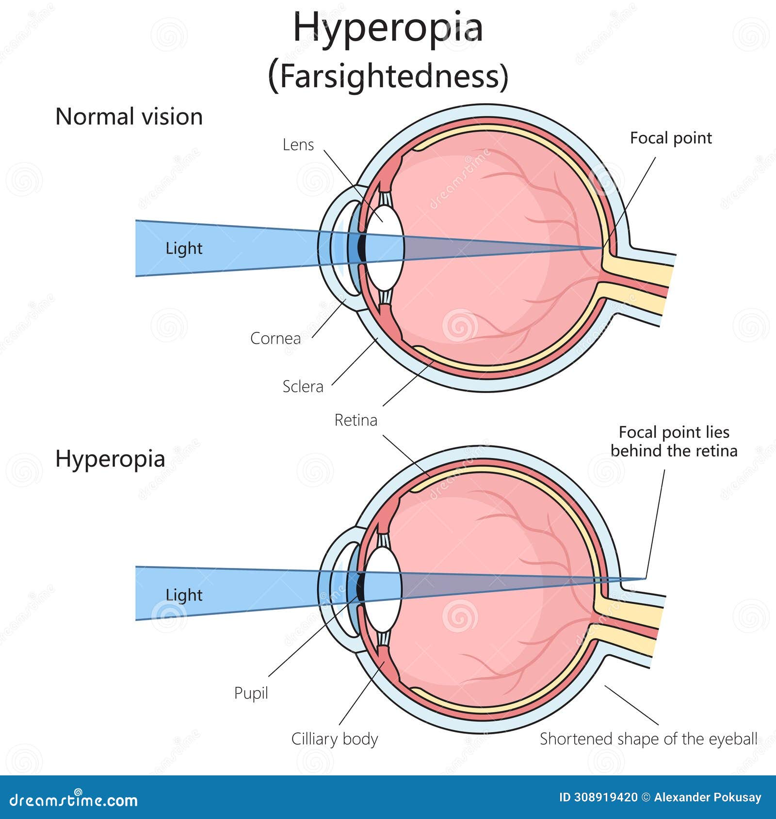 Farsightedness Structure Diagram Medical Science Stock Illustration ...