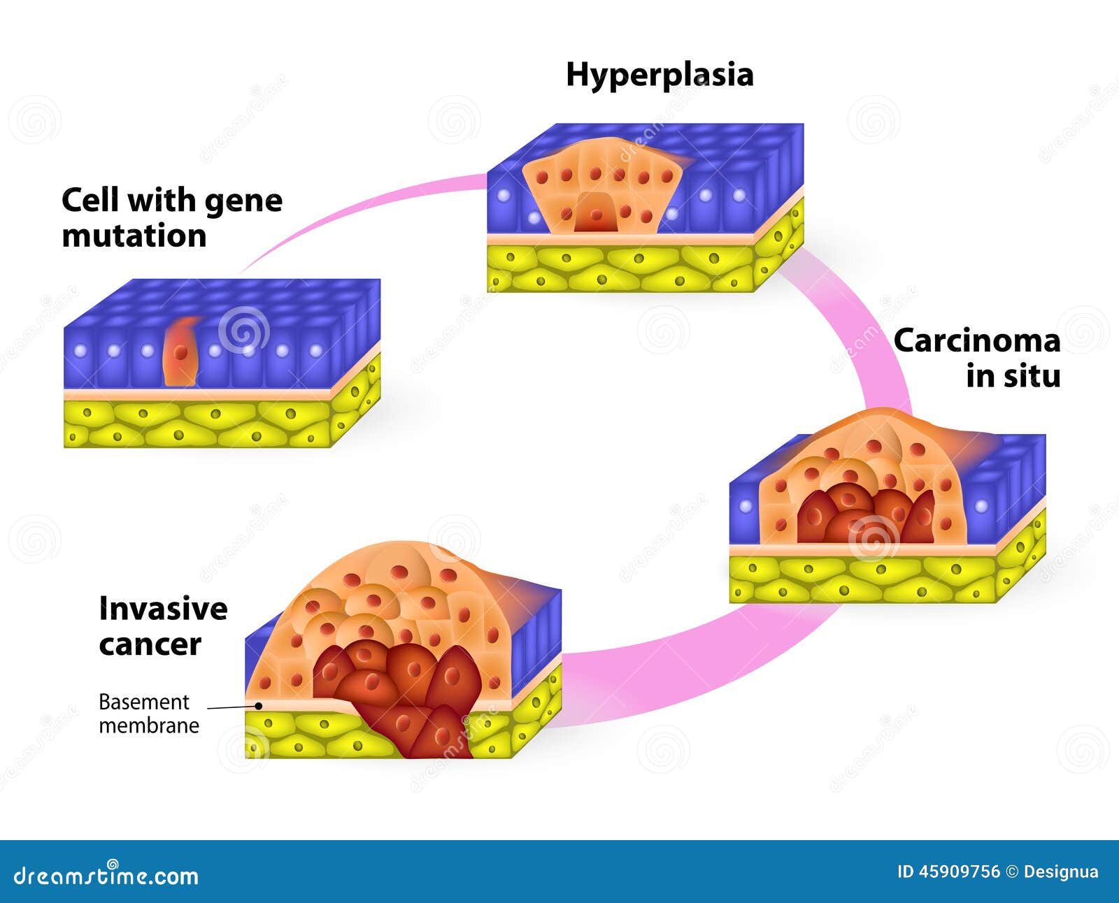 Fases De Desarrollo De Cáncer Ilustración del Vector - Imagen: 45909756