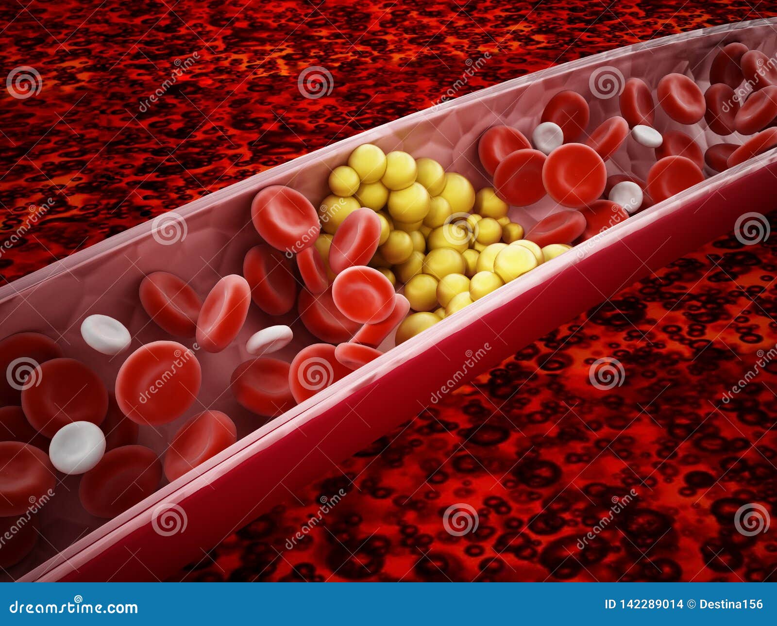 Fat Cells Blocking the Blood Flow Inside Human Vein. 3D Illustration ...