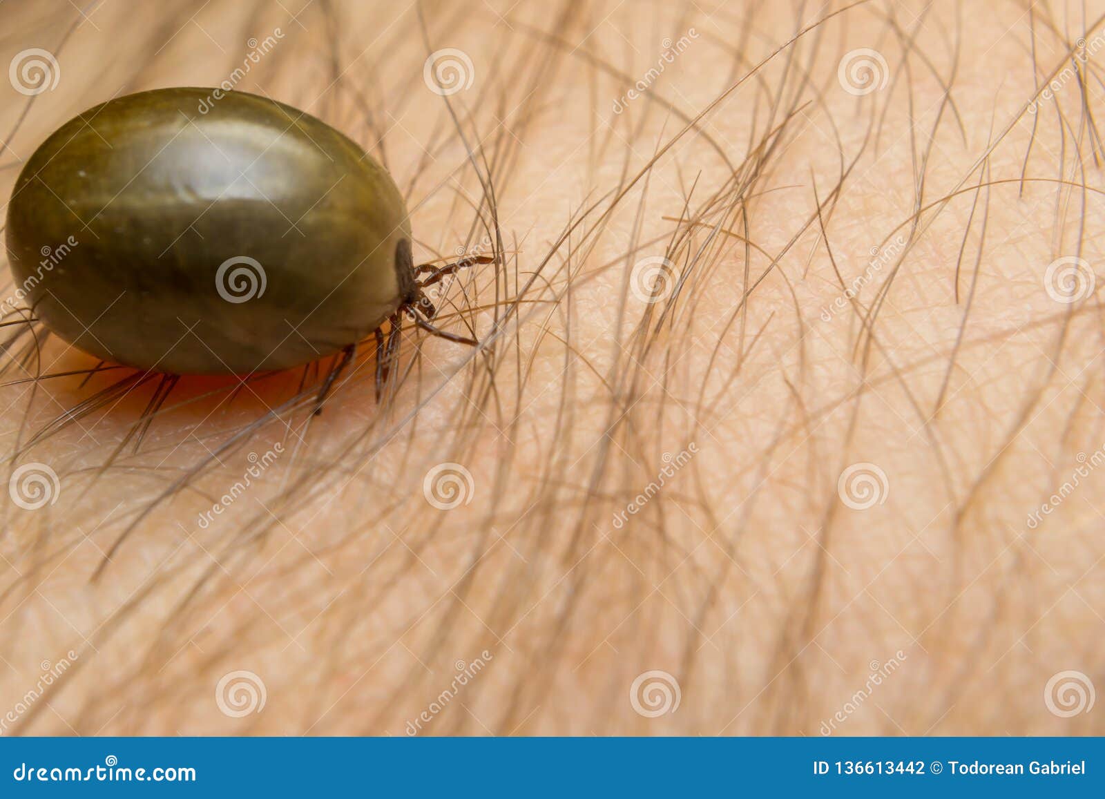 Tick on skin surface stock photo. Image of tick, arachnid - 136613442