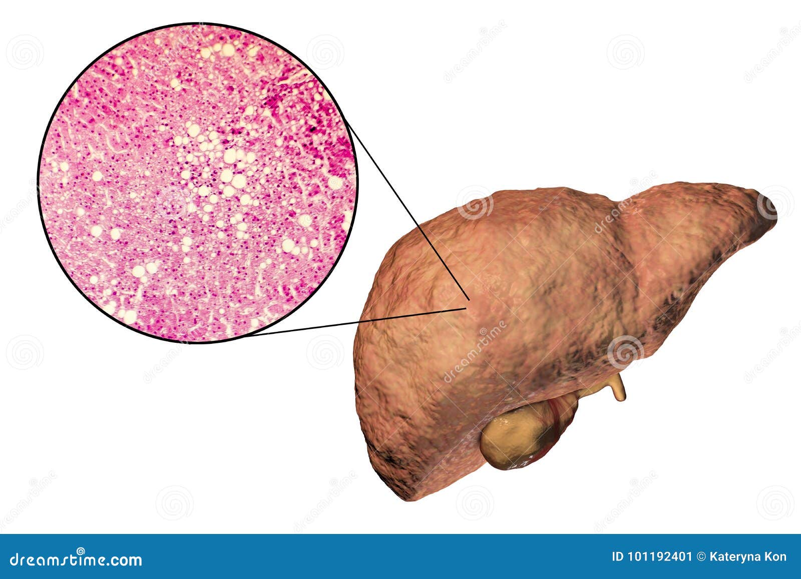 Fatty Liver, Liver Steatosis Stock Illustration - Illustration of cell ... Fatty Liver, Liver Steatosis Stock Illustration - Illustration of cell ...