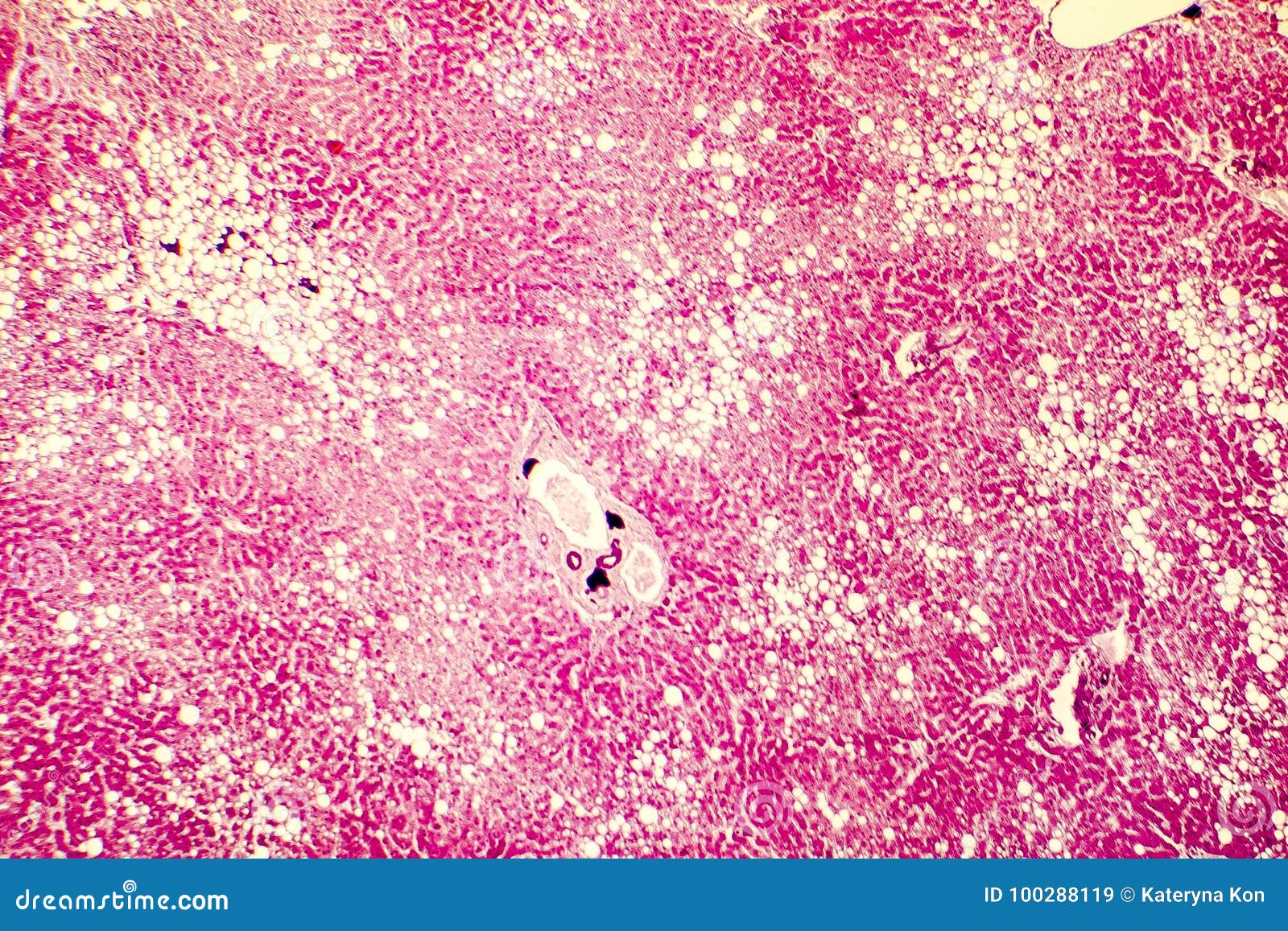 Light Micrograph of a Fatty Liver Stock Image - Image of biopsy ... Light Micrograph of a Fatty Liver Stock Image - Image of biopsy ...