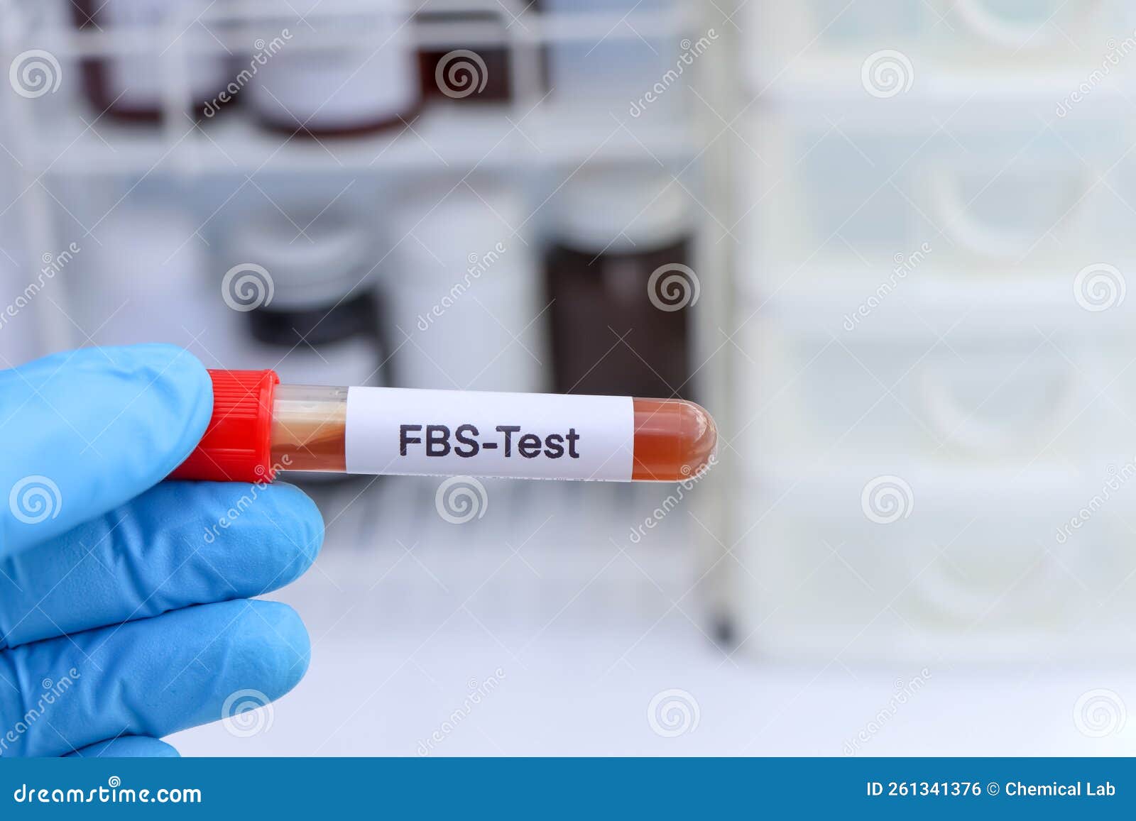 FBS Test To Look for Abnormalities from Blood Stock Photo - Image of ...