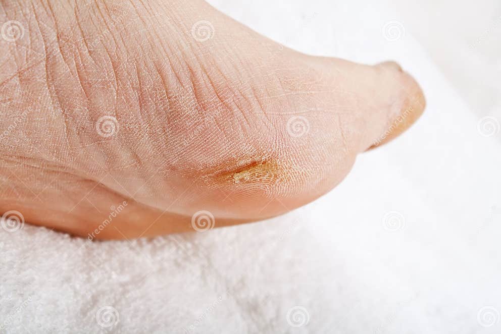 Feet that need a pedicure stock image. Image of condition - 22555093
