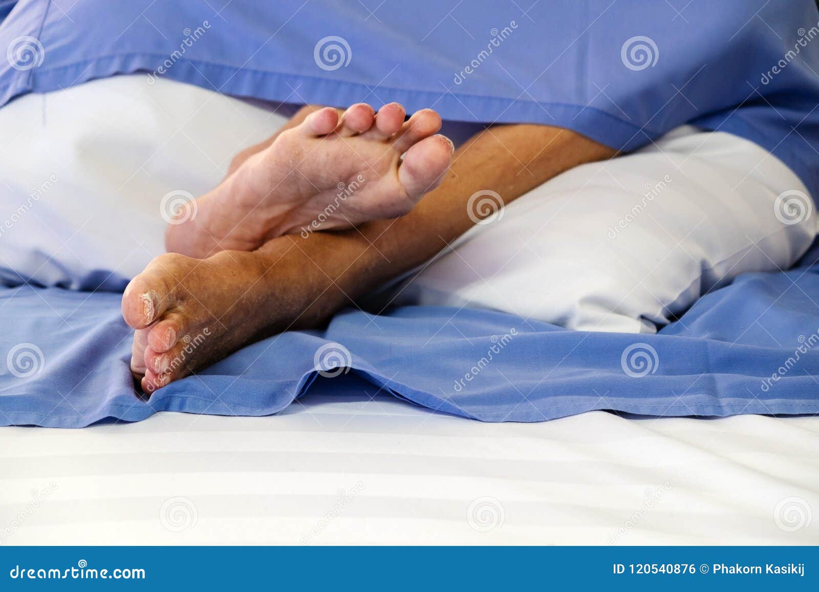 Feet of Paralysis Patients on the Hospital Bed Stock Photo - Image of ...