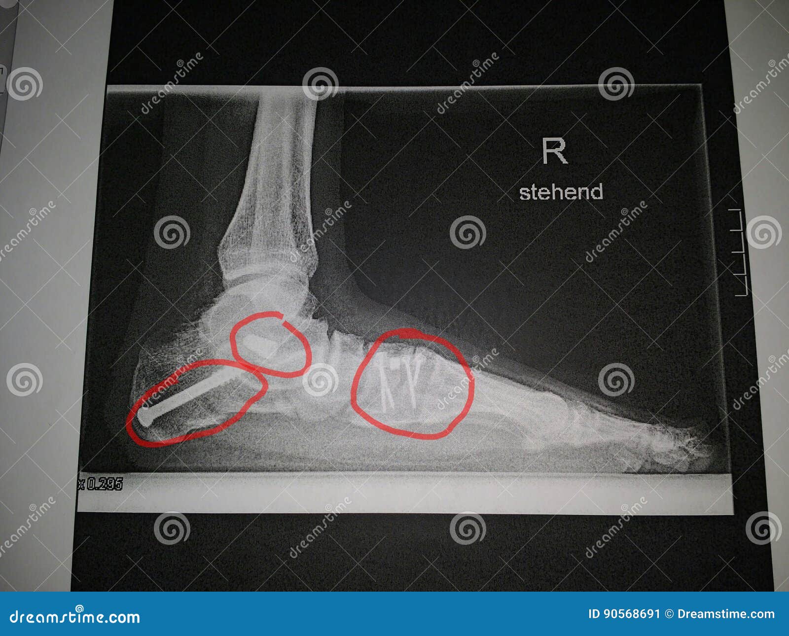 Feet stock image. Image of operation, feet, surgery, rehabilitation ...