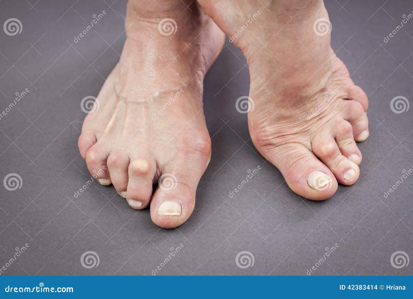 Feet of Woman Deformed from Rheumatoid Arthritis Stock Photo - Image of ...