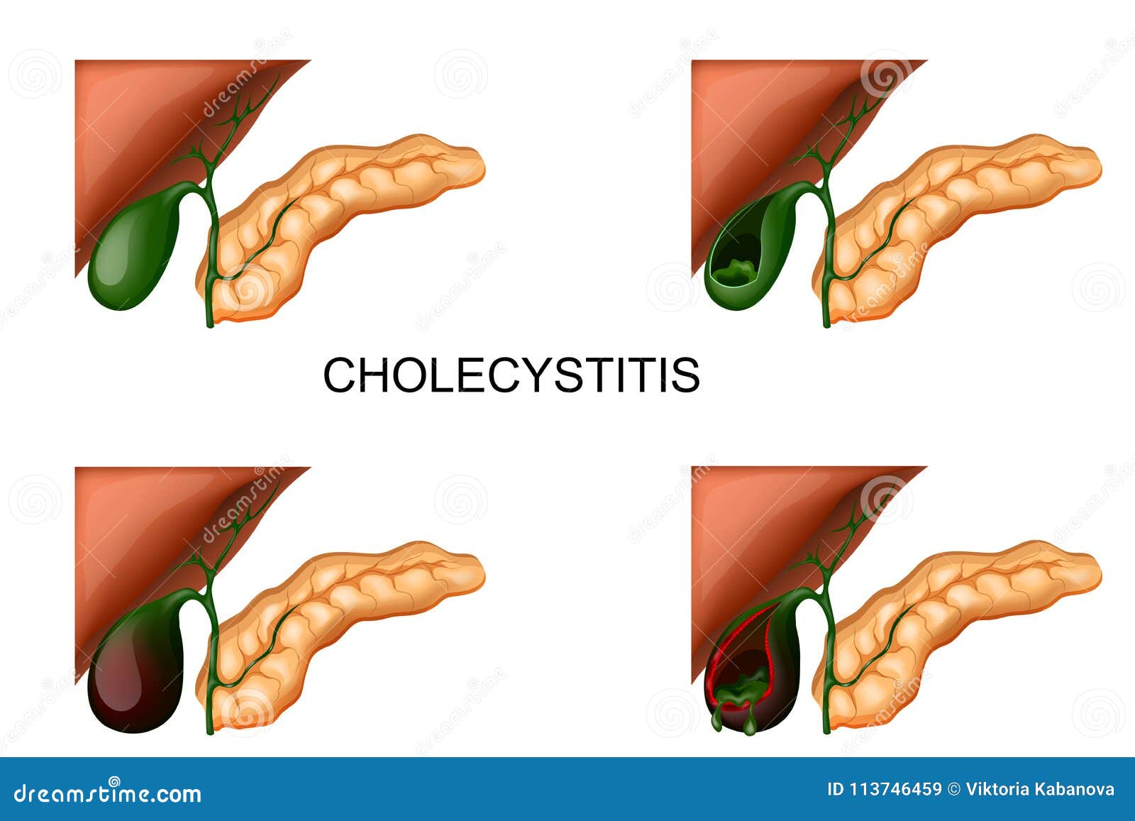 Fegato, Cistifellea E Pancreas Colecistite Illustrazione Vettoriale ...