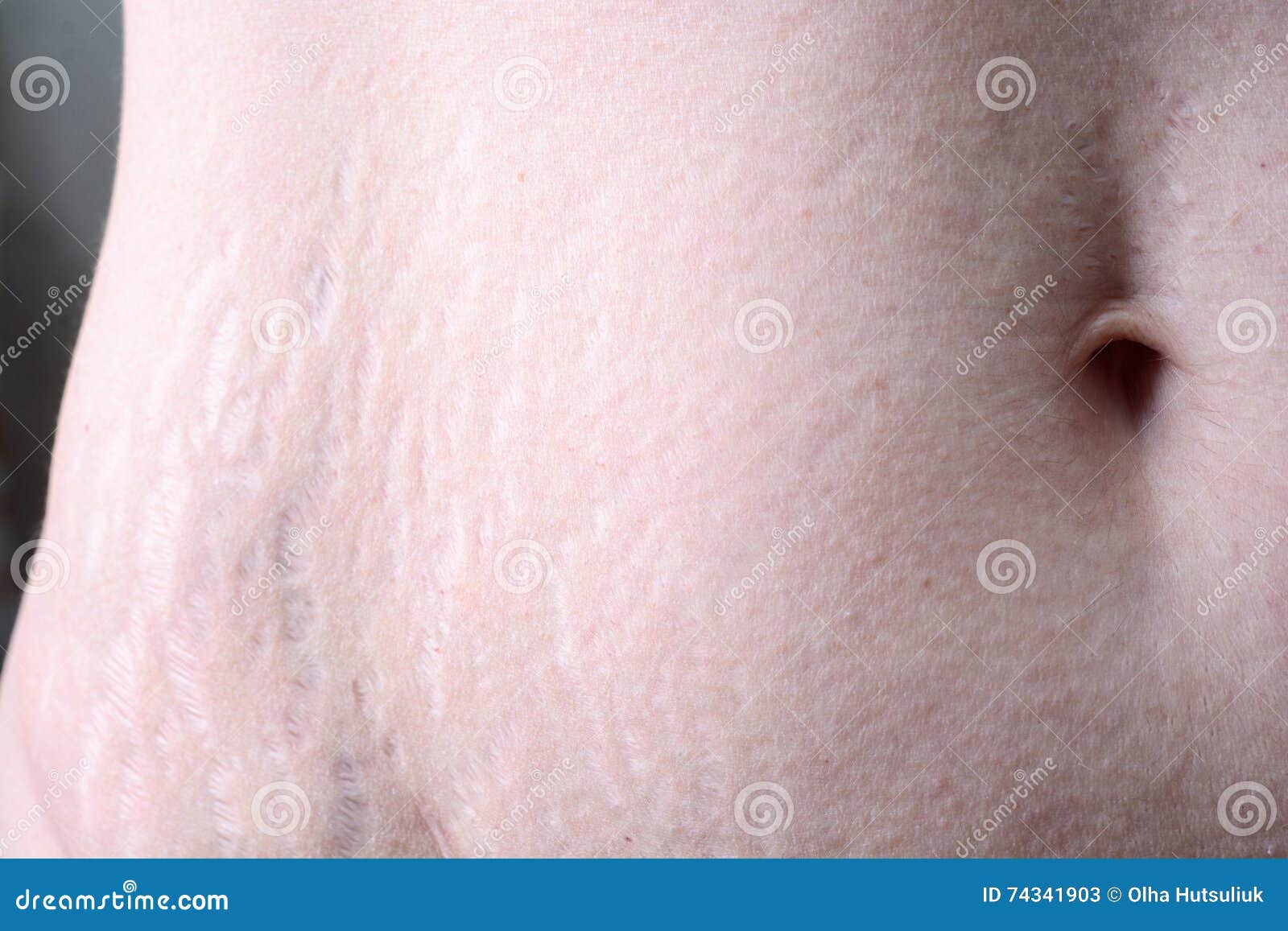 Red Stretch Mark Stock Photos - Royalty Free Images