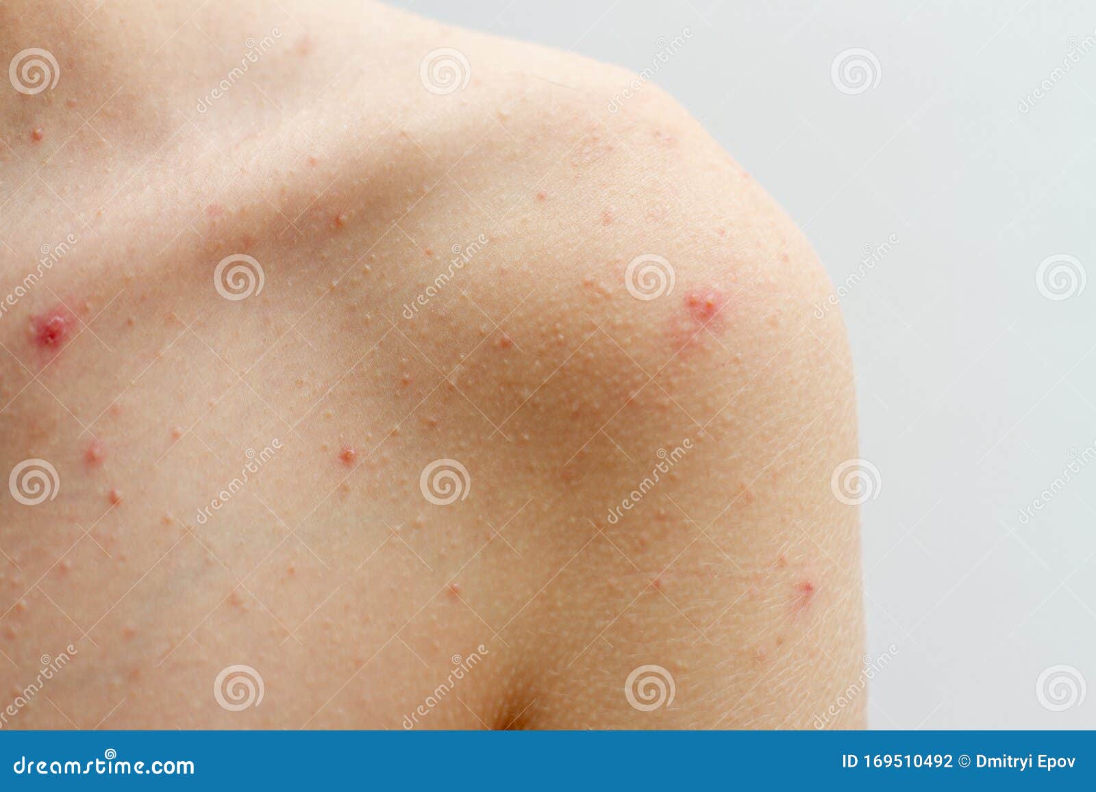Female Body Shoulder with Skin in Pimples Stock Photo - Image of ...