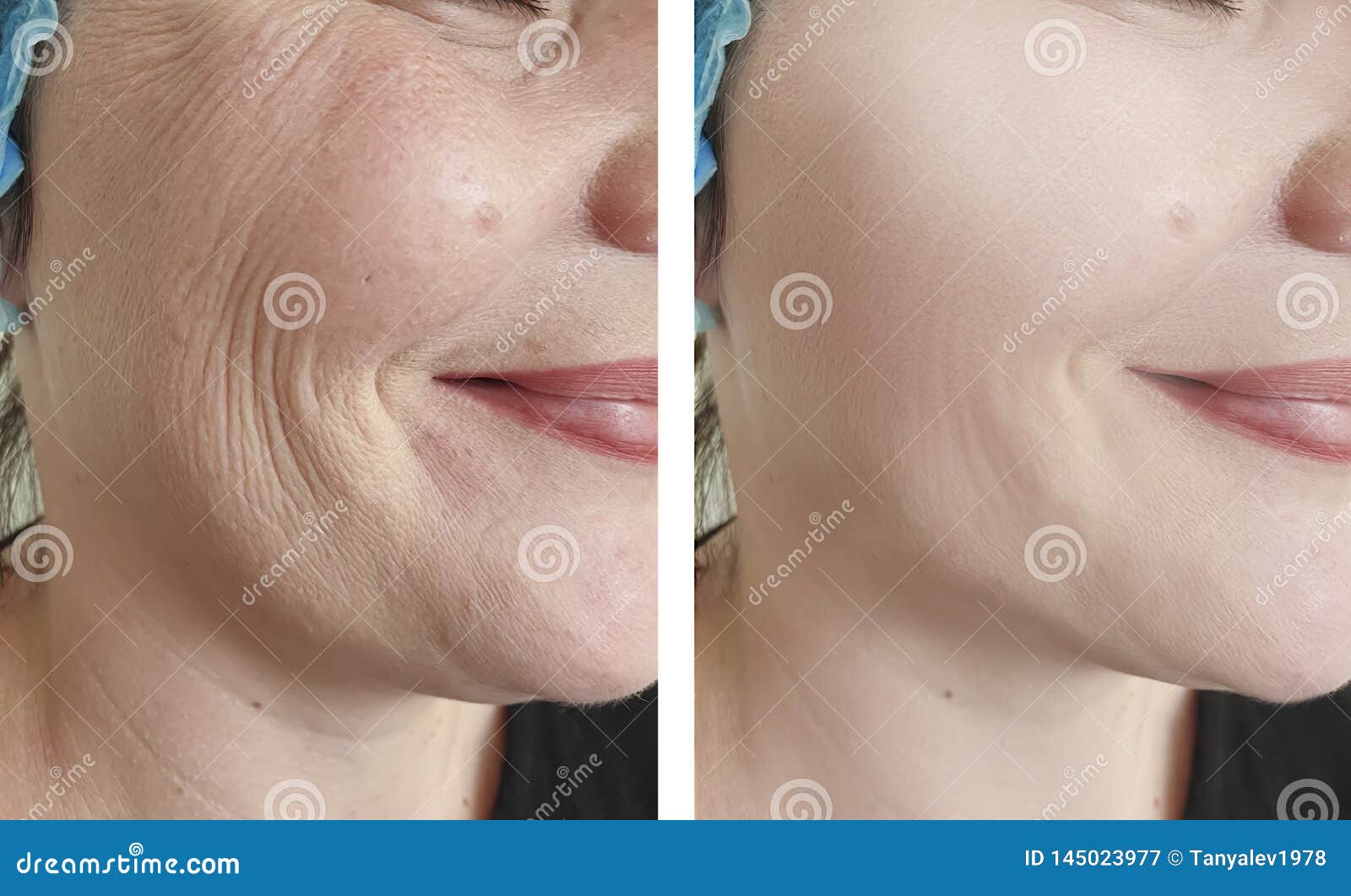 Female Elderly Wrinkles before Difference after Lifting Correction ...