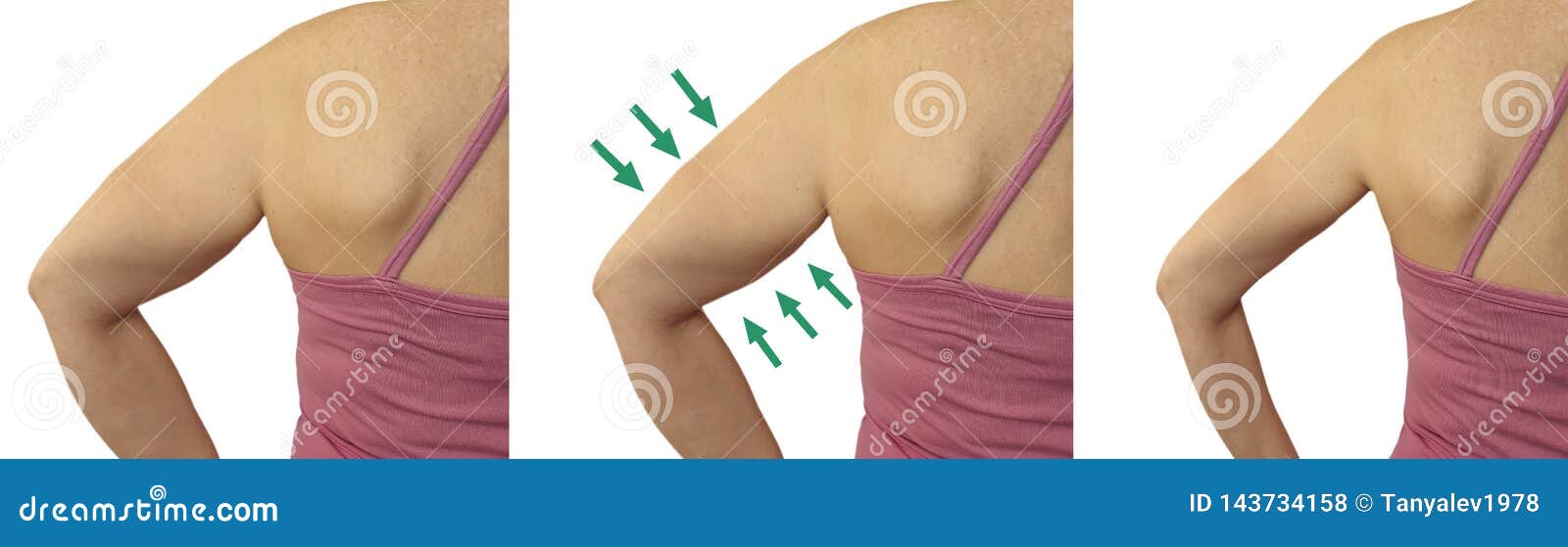 Female Hand Slimming before after Obesity Stock Photo - Image of loss ...