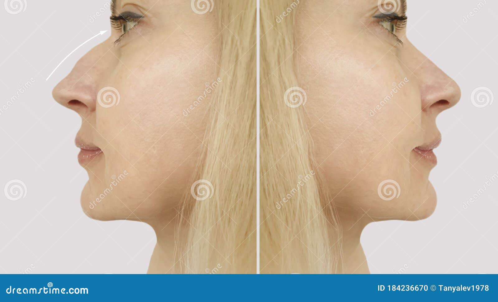 Female Humpback Nose before and after Treatment Stock Photo - Image of ...