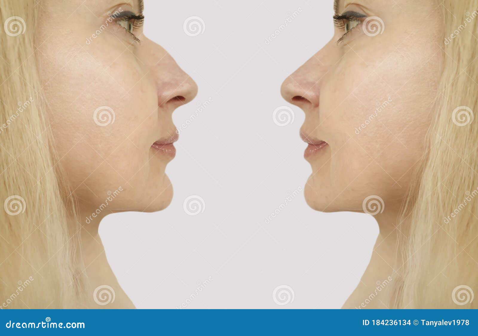 Female Humpback Nose before and after Problem Treatment Stock Photo ...