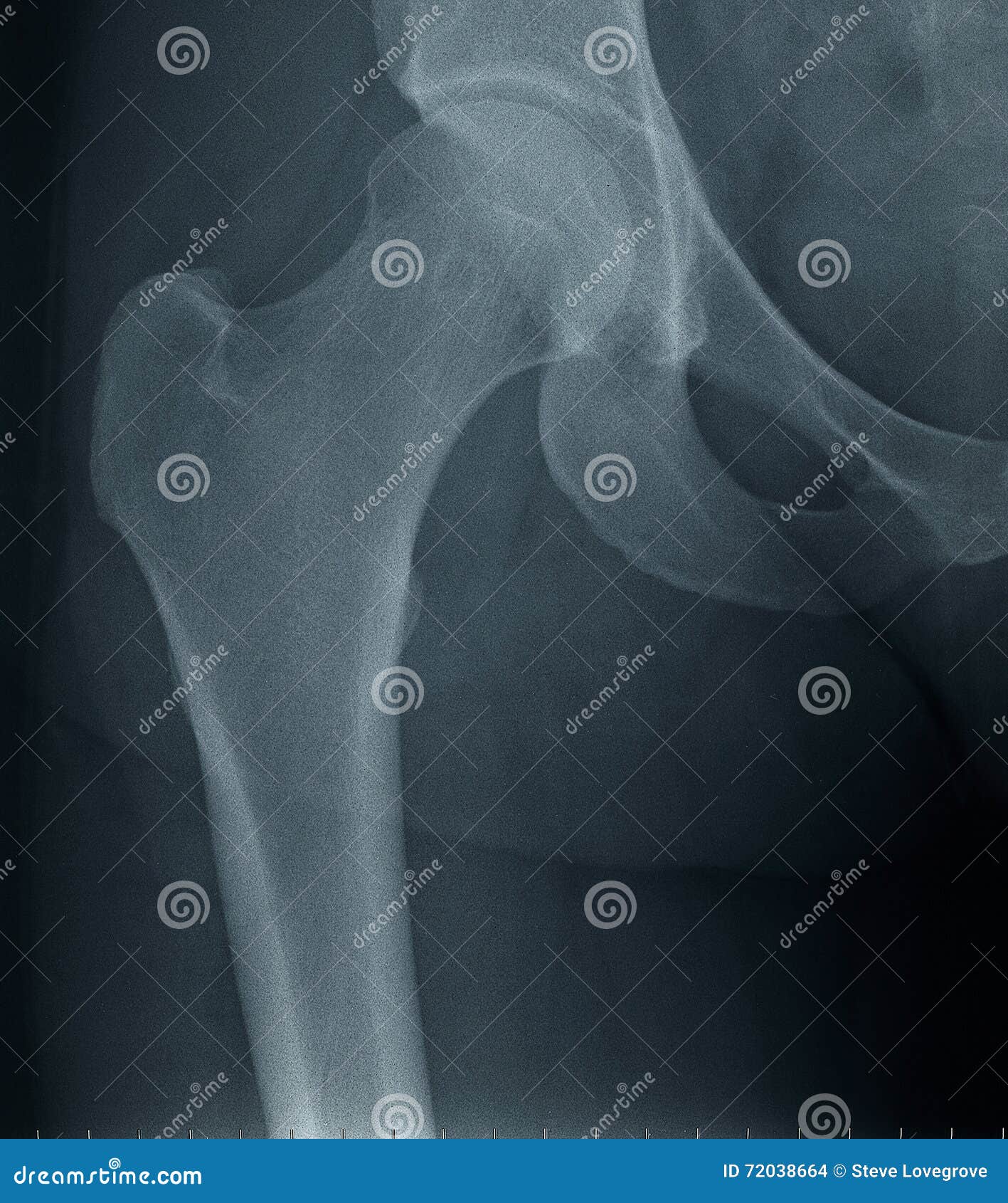 Female Left Hip X-Ray stock photo. Image of medicine - 72038664