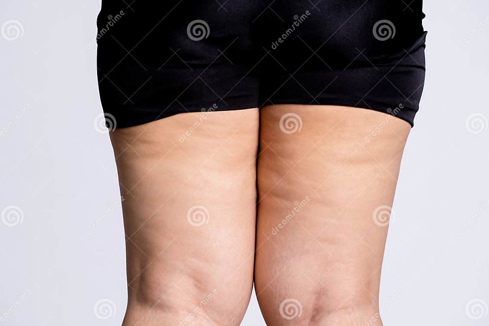 Female Legs With Cellulite Skin And Body Care Concept Stock Image Image Of Perfect Remove