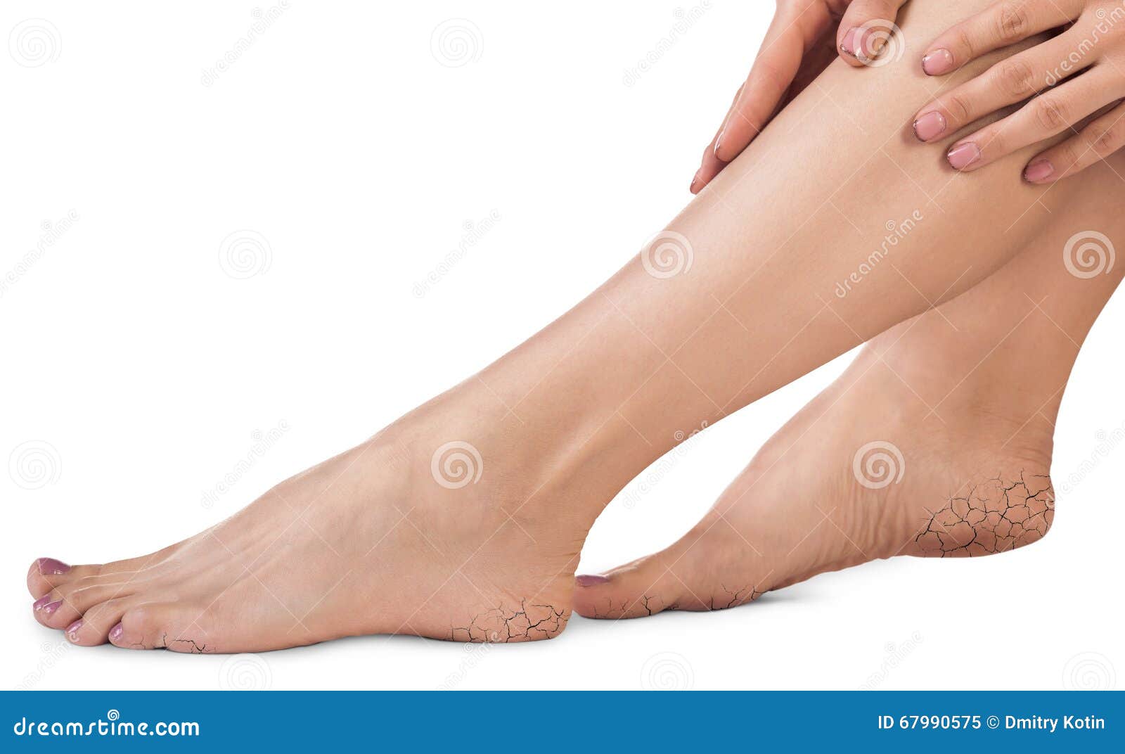 Female legs with cracks stock image. Image of dirty, human - 67990575
