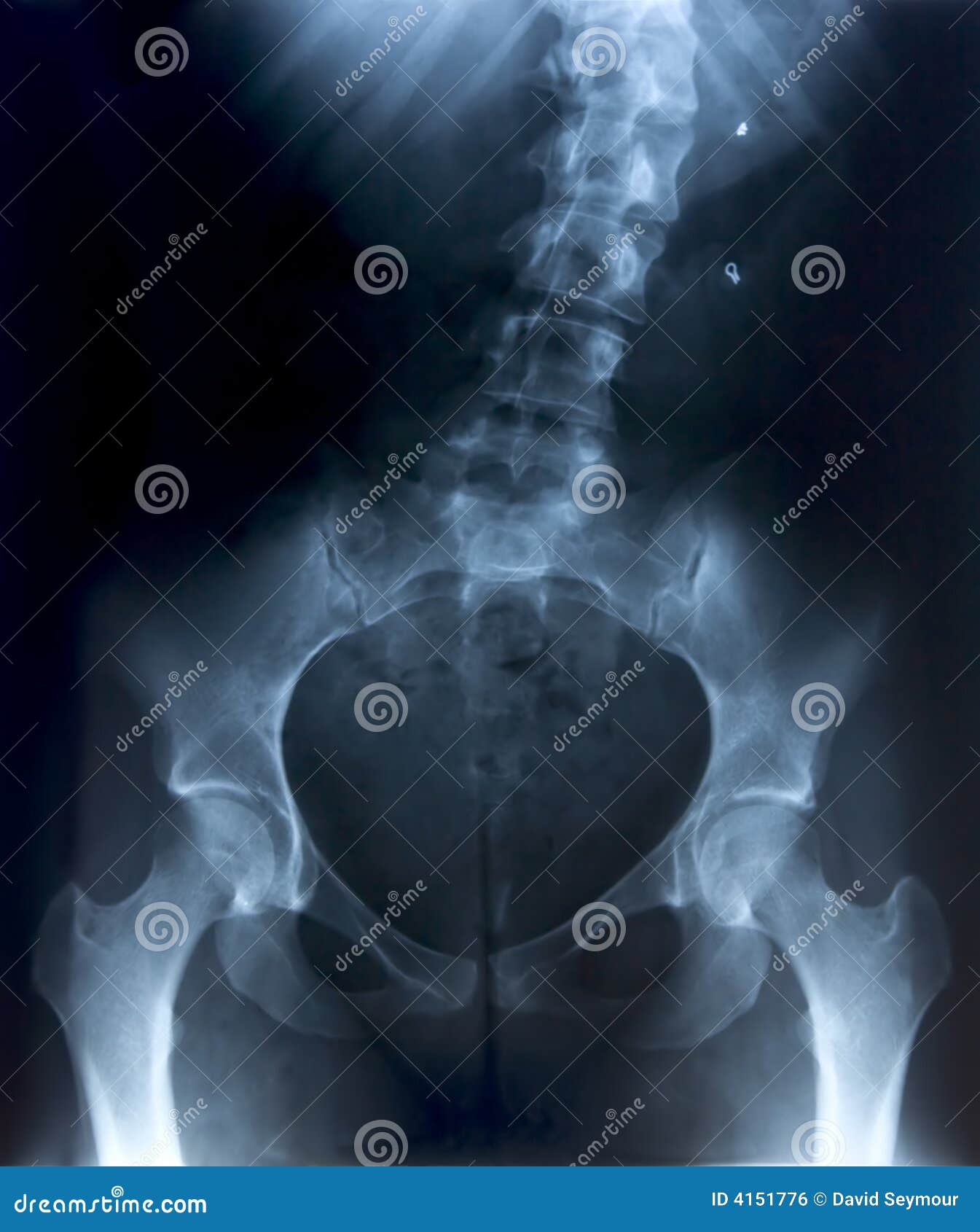 Female Pelvis X-Ray stock photo. Image of femur, lamina - 4151776