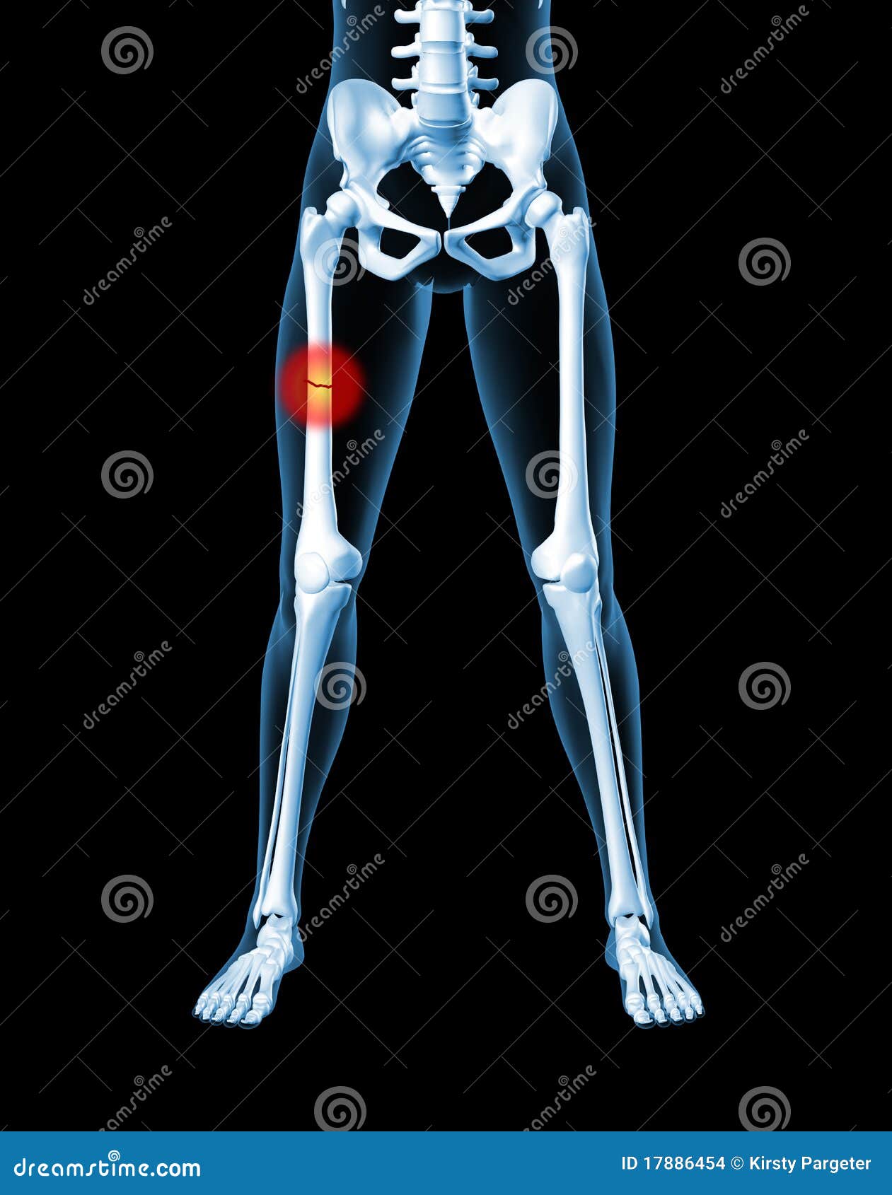 Female Skeleton With Broken Leg Bone Royalty-Free Stock Image ...