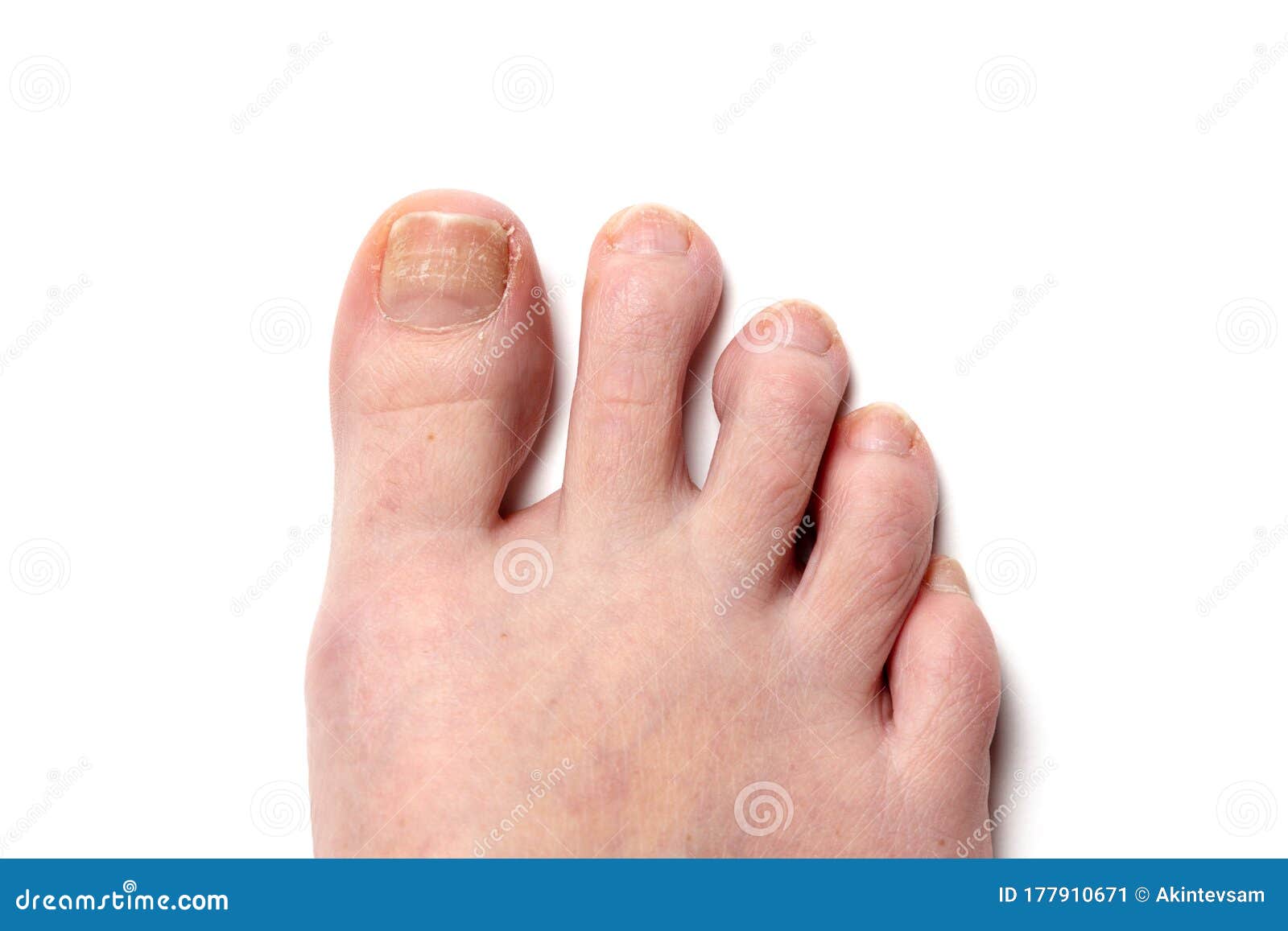 Female Toenails without Pedicure Stock Image - Image of foot, closeup ...