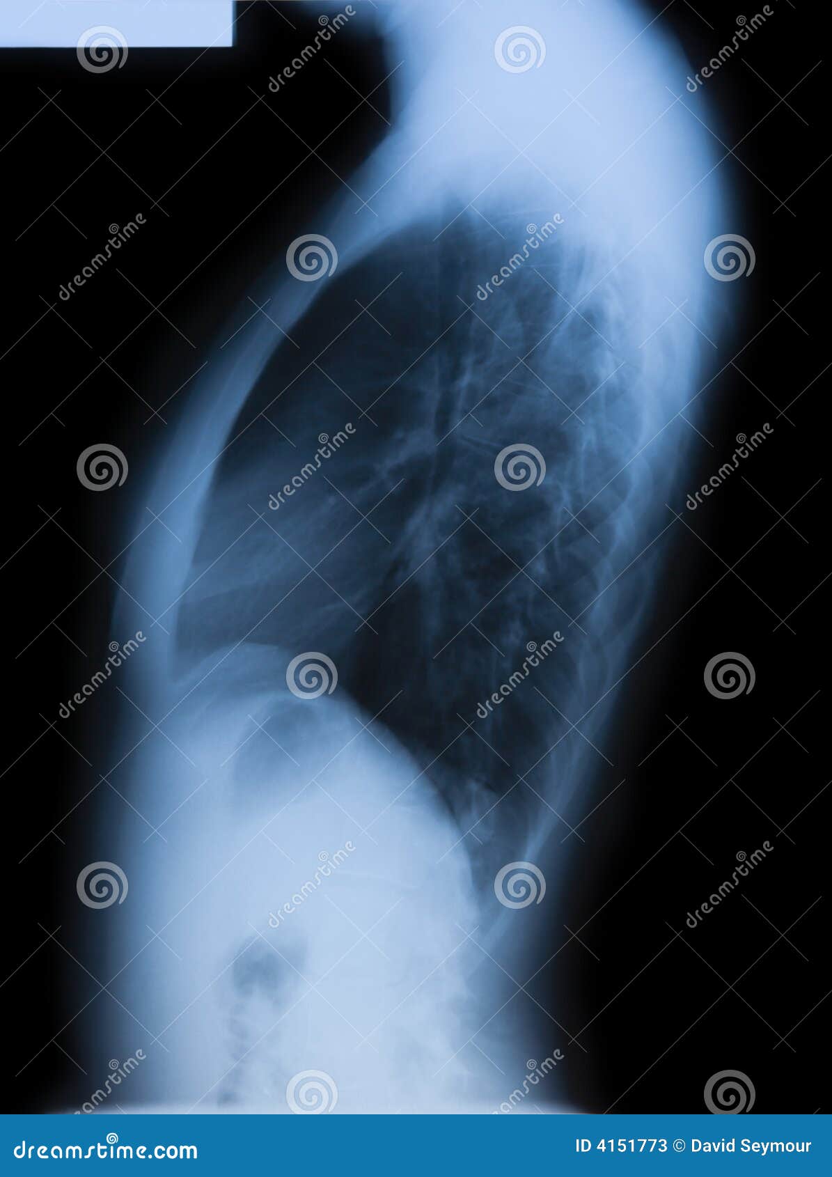 Female Torso x-ray stock image. Image of ligaments, healing - 4151773