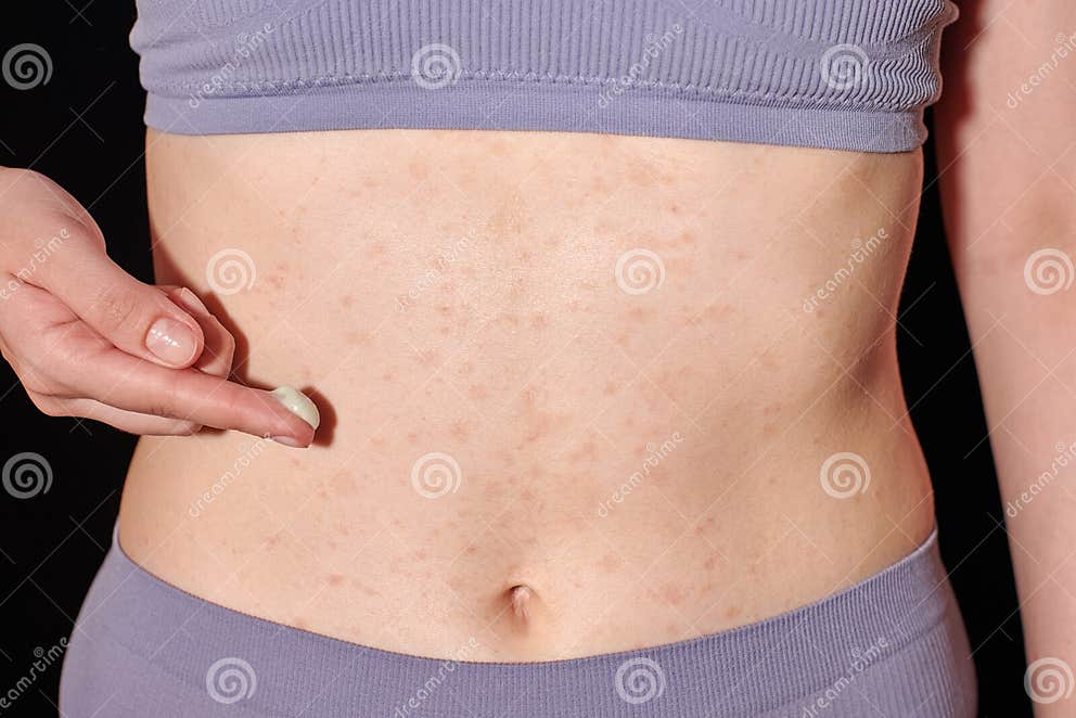 Red Allergic Rash On Belly Skin Atopic Dermatitis Eczema Inflammation Woman Applying