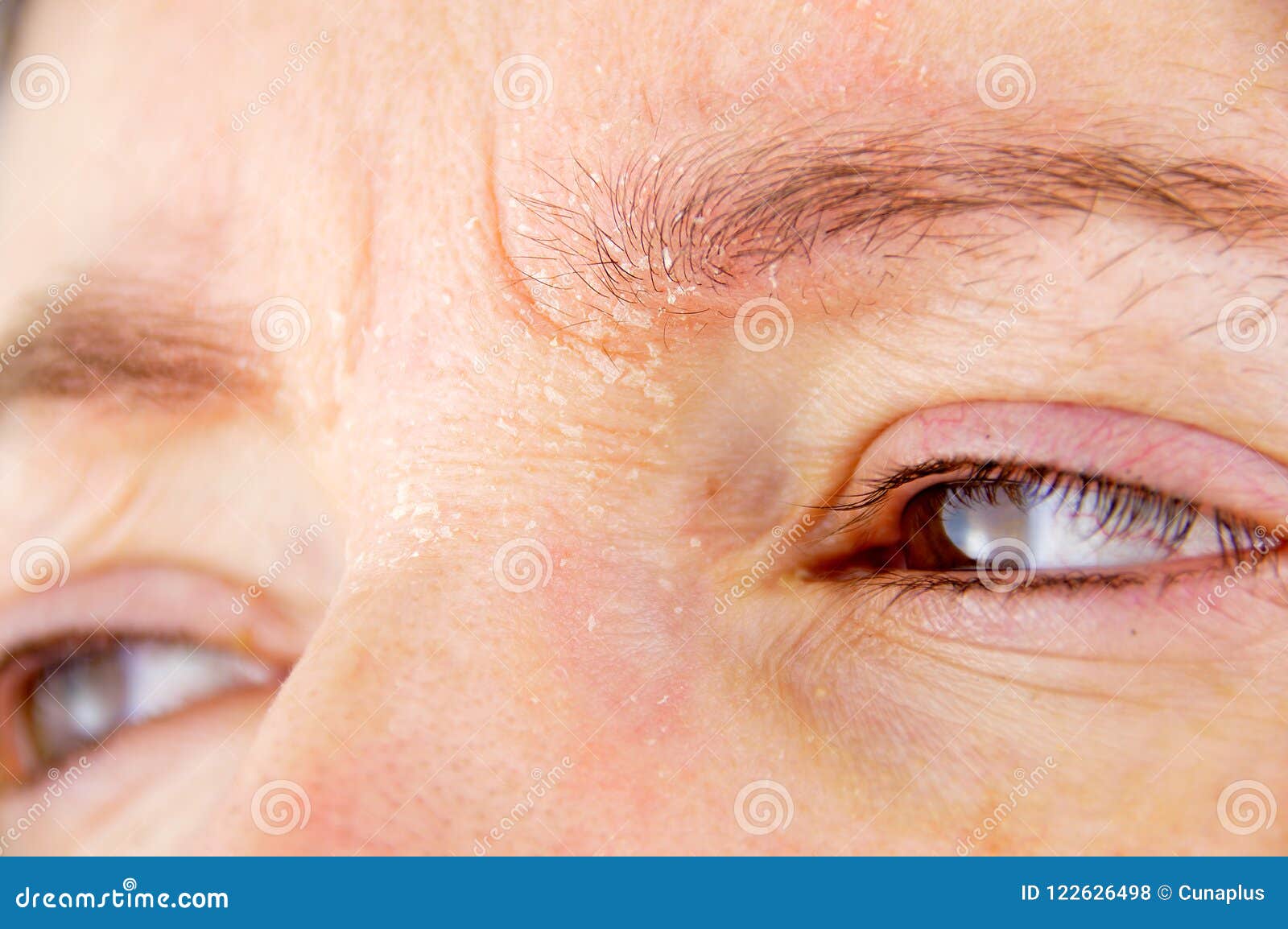 Femme Avec La Dermatite Atopique Photo stock - Image du caucasien ...