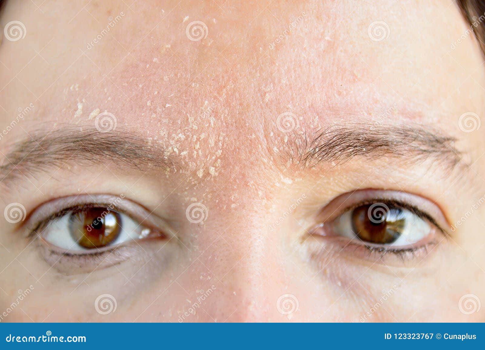 Femme Avec La Dermatite Atopique Image stock - Image du femelle ...