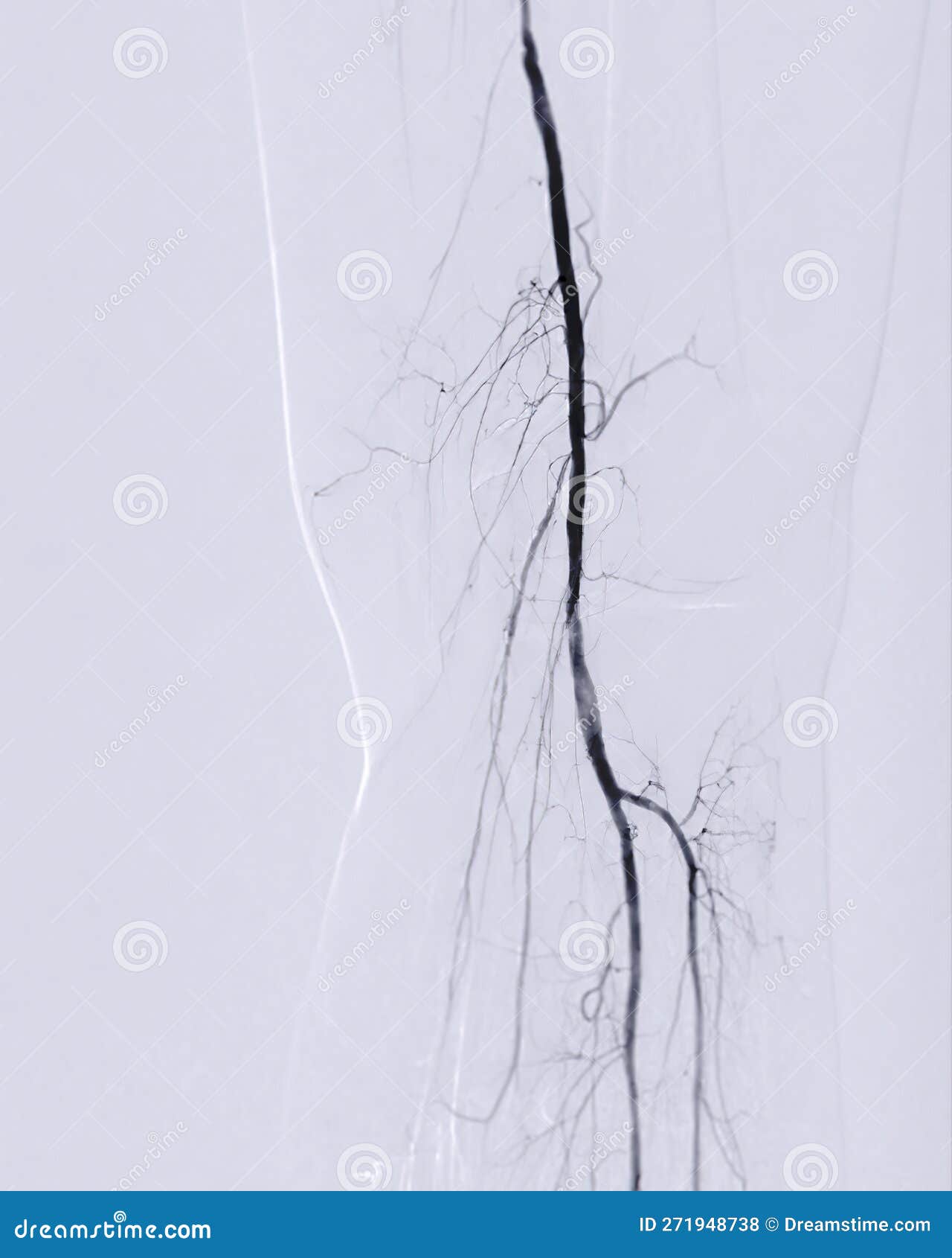 Femoral Artery Angiogram or Angiography Stock Photo - Image of media ...