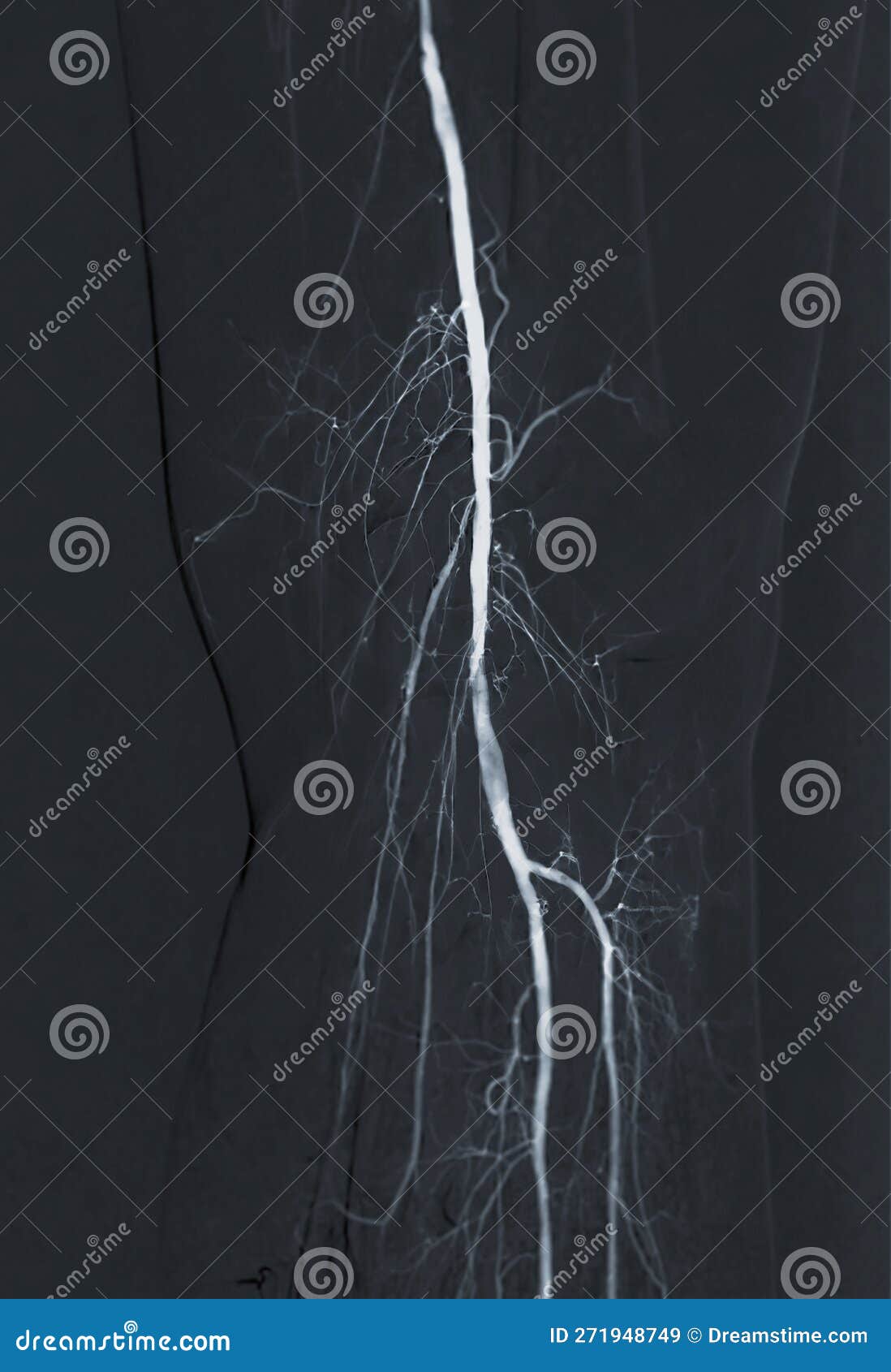Femoral Artery Angiogram or Angiography Stock Image - Image of system ...