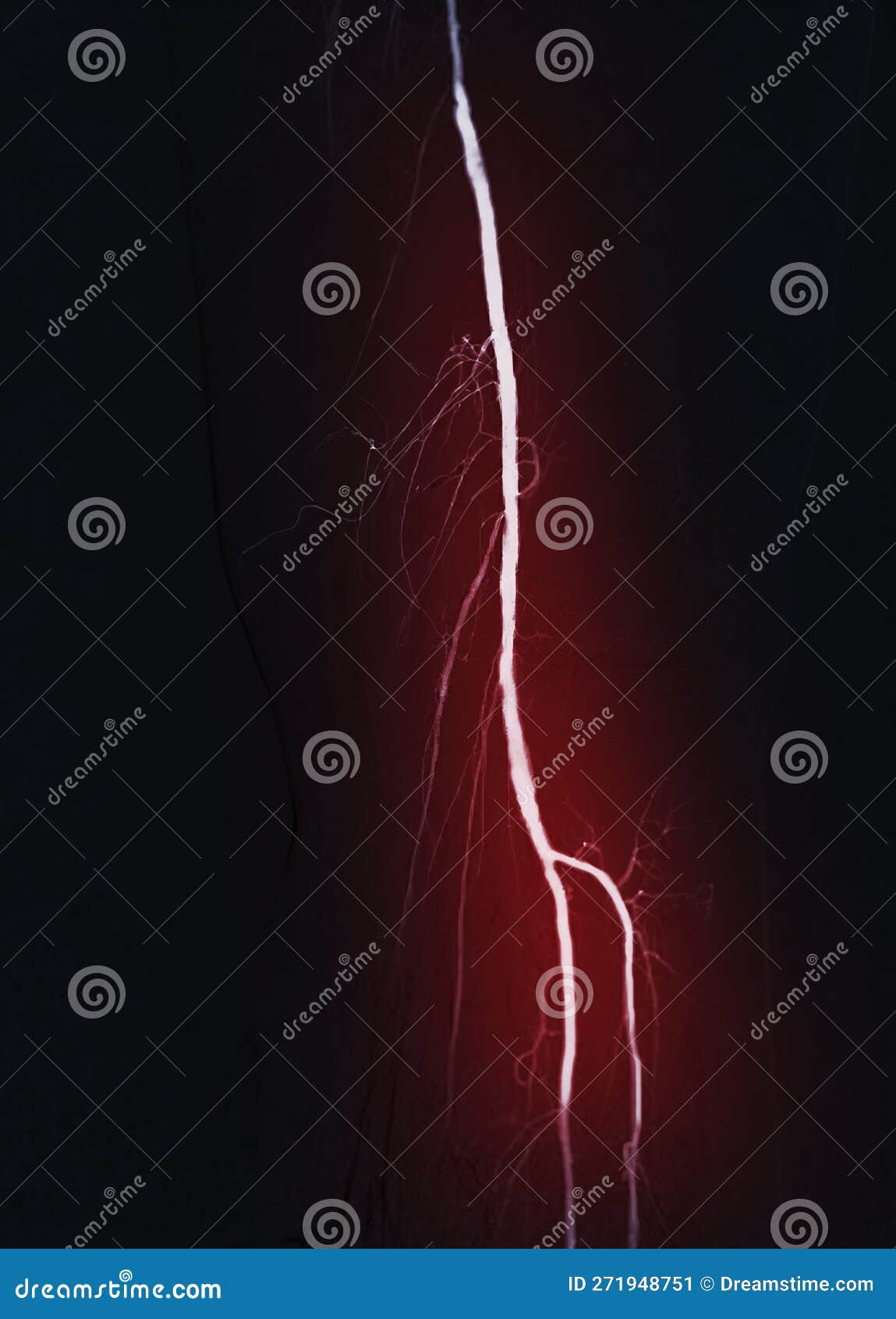 Femoral Artery Angiogram or Angiography Stock Image - Image of ...